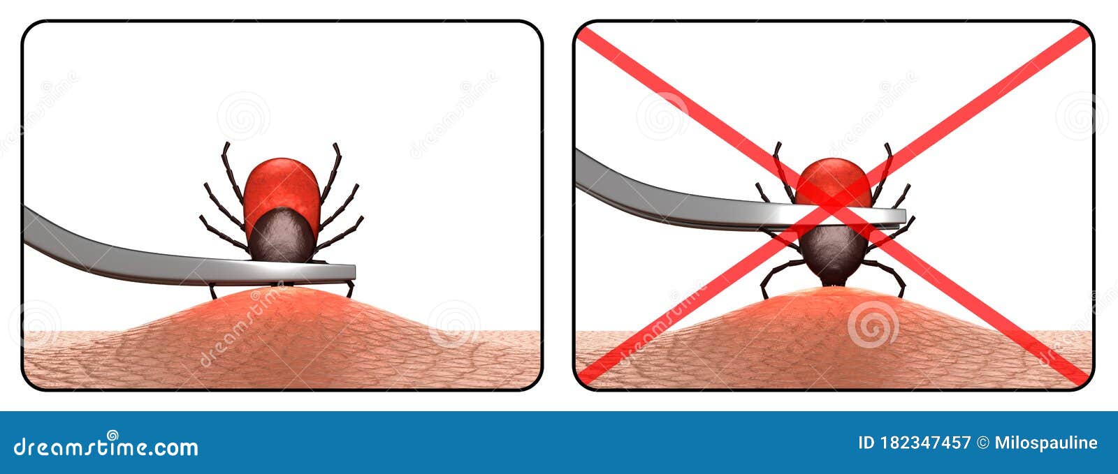How To Remove A Tick. The Correct Way Using Forceps. 3D-rendering ...