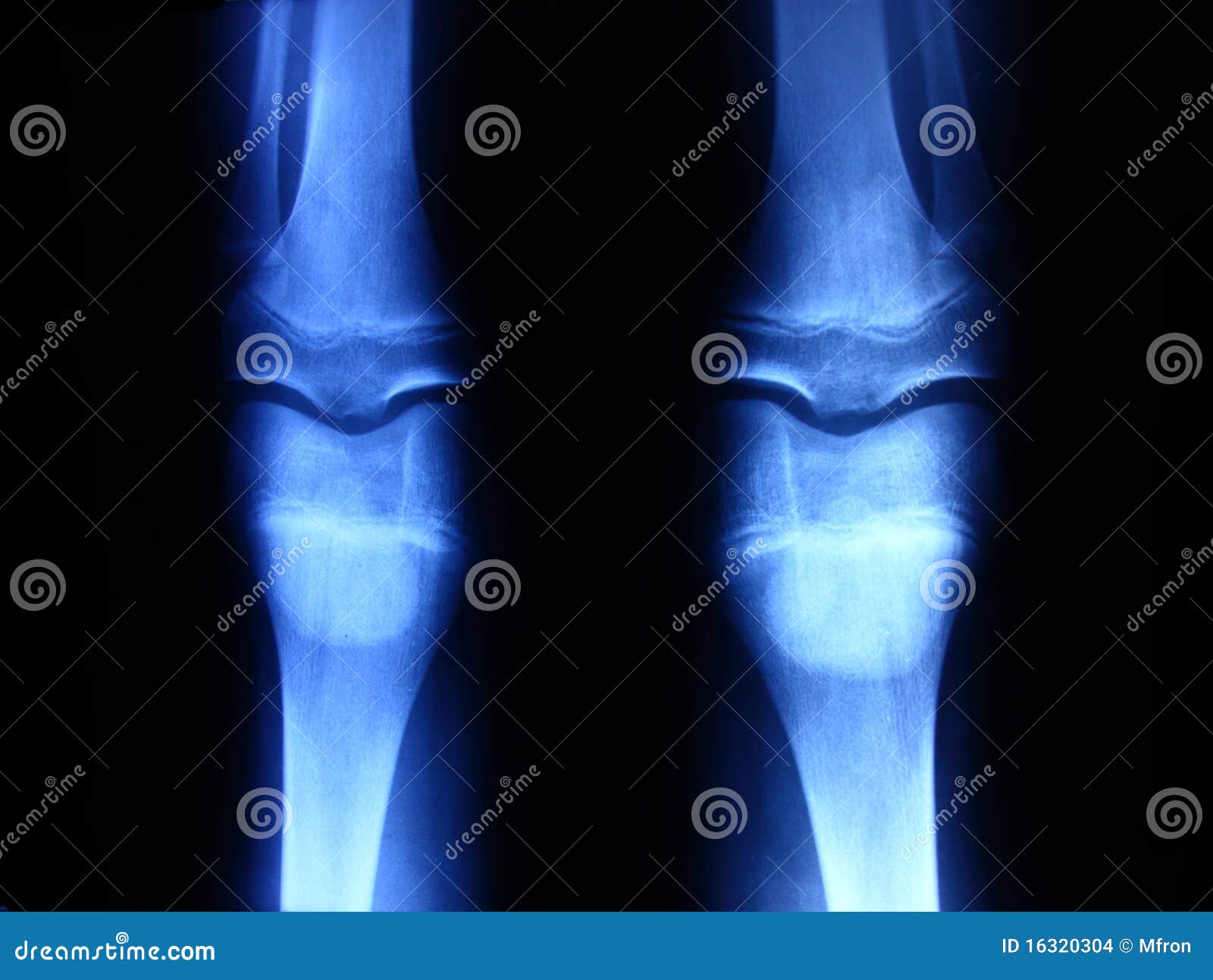 Huesos de la rodilla foto de archivo. Imagen de examen - 16320304
