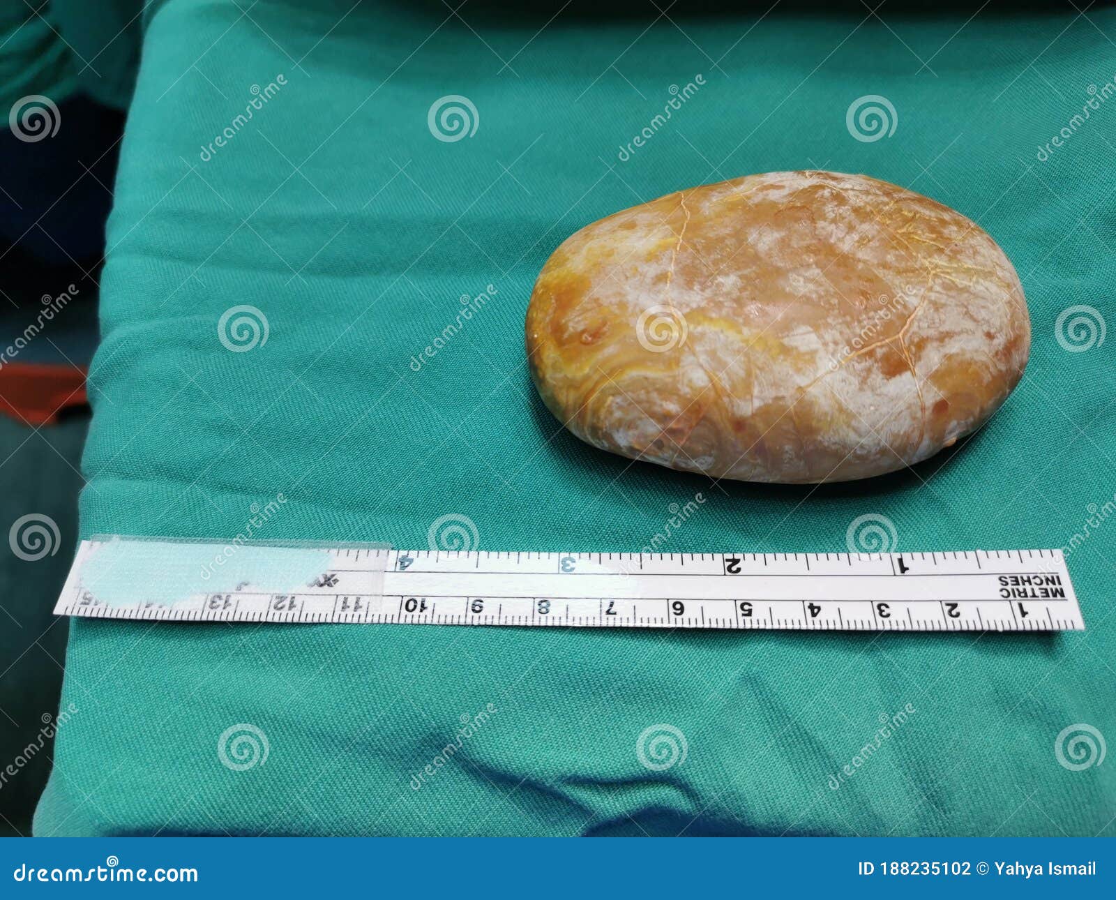 Huge Laminated Stone in Urinary Bladder Extracted Via Open ...