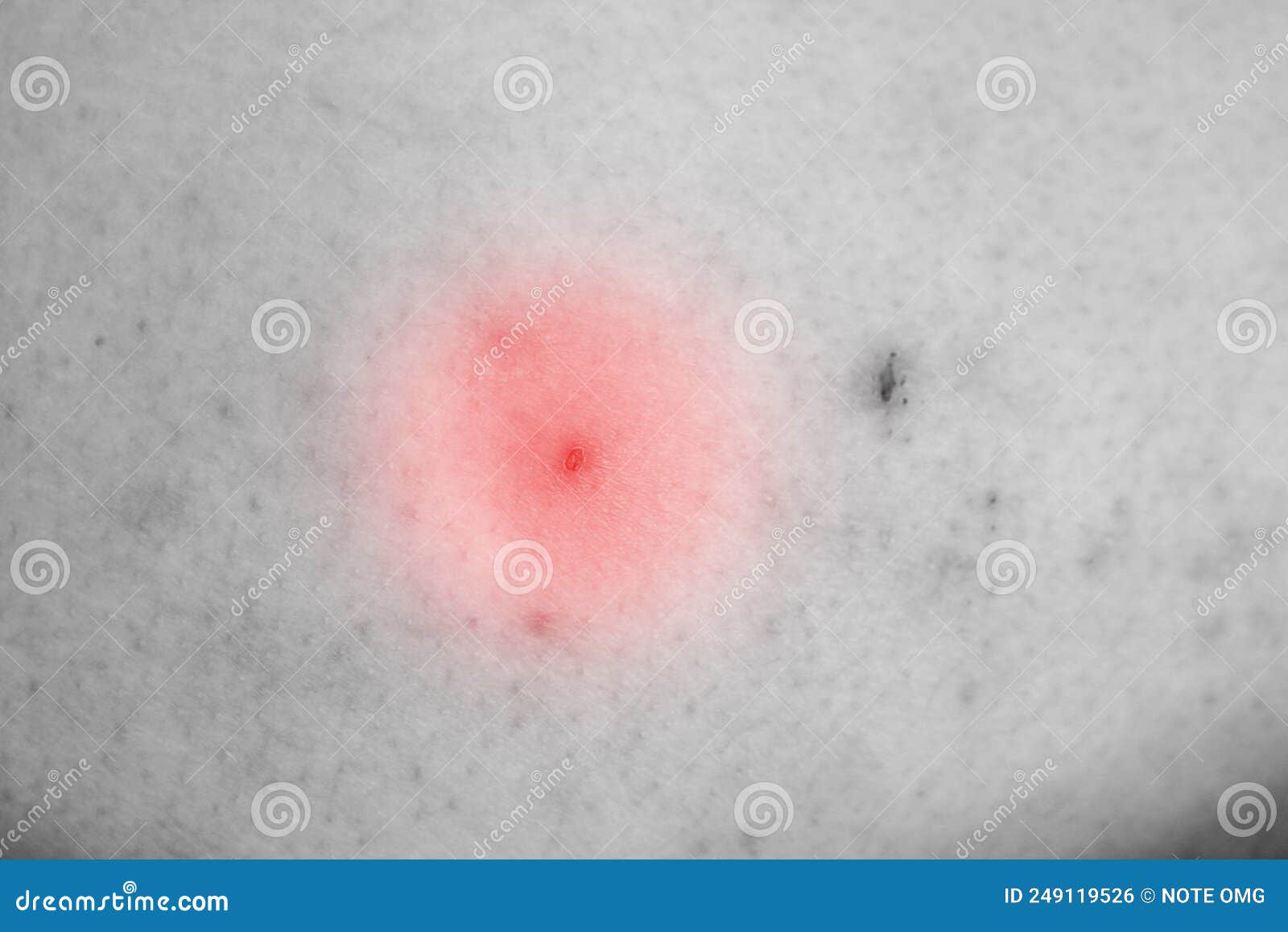 Human Abscess Injury. Highlight a Single Color on the Abscess Stock ...