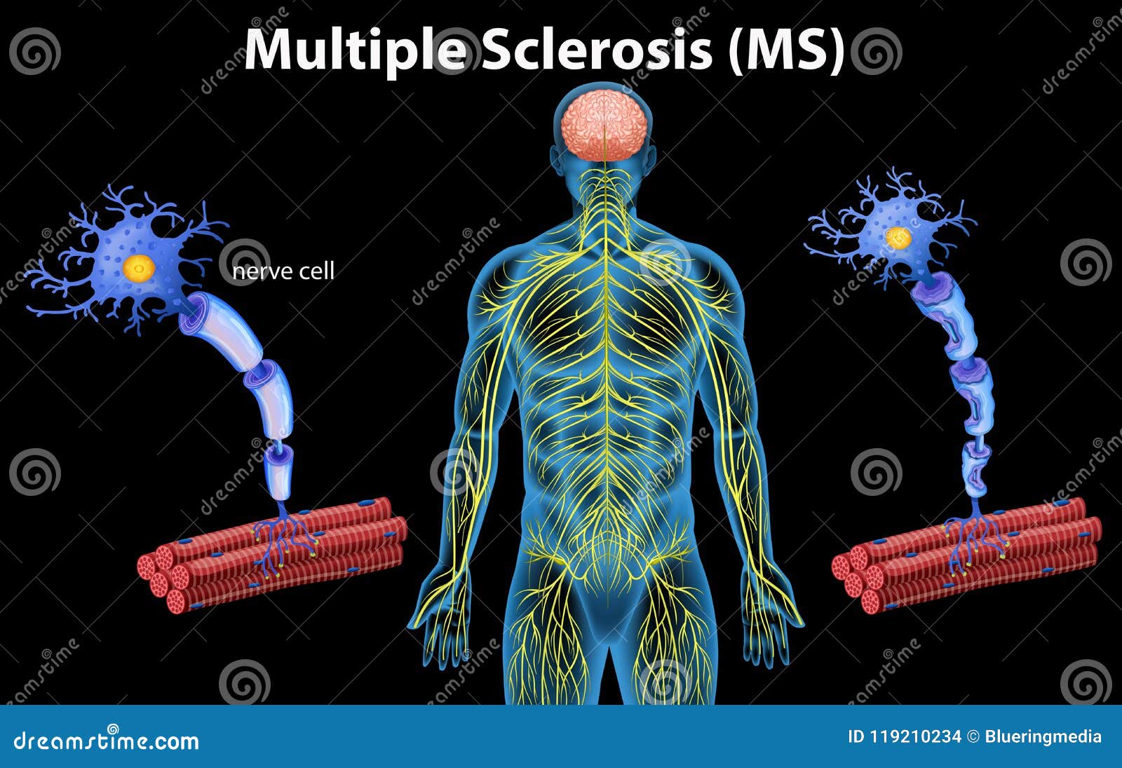 Human Anatomy of Multiple Sclerosis Stock Vector - Illustration of ...