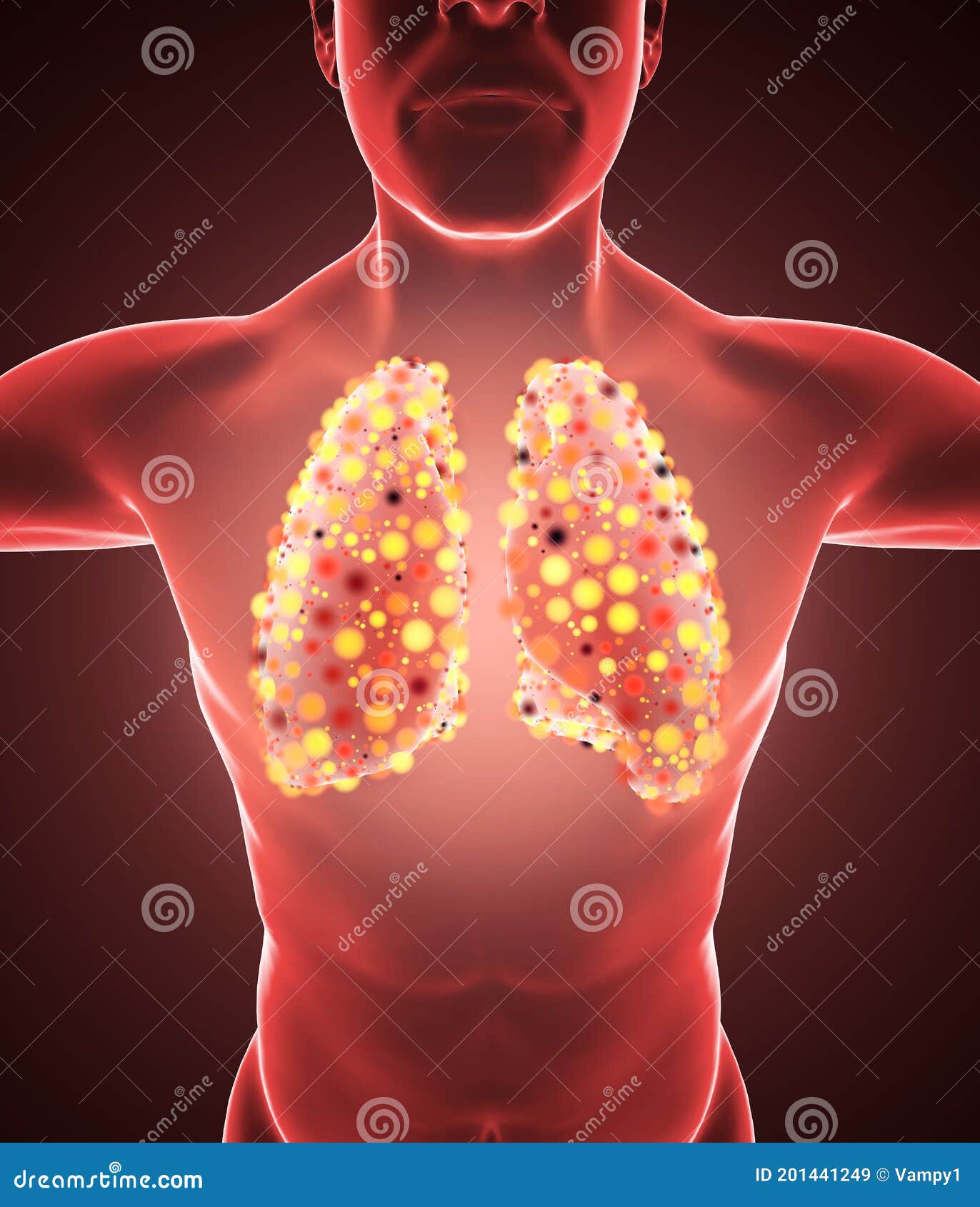 Human Anatomy, Problems with the Respiratory System, Severely Damaged ...