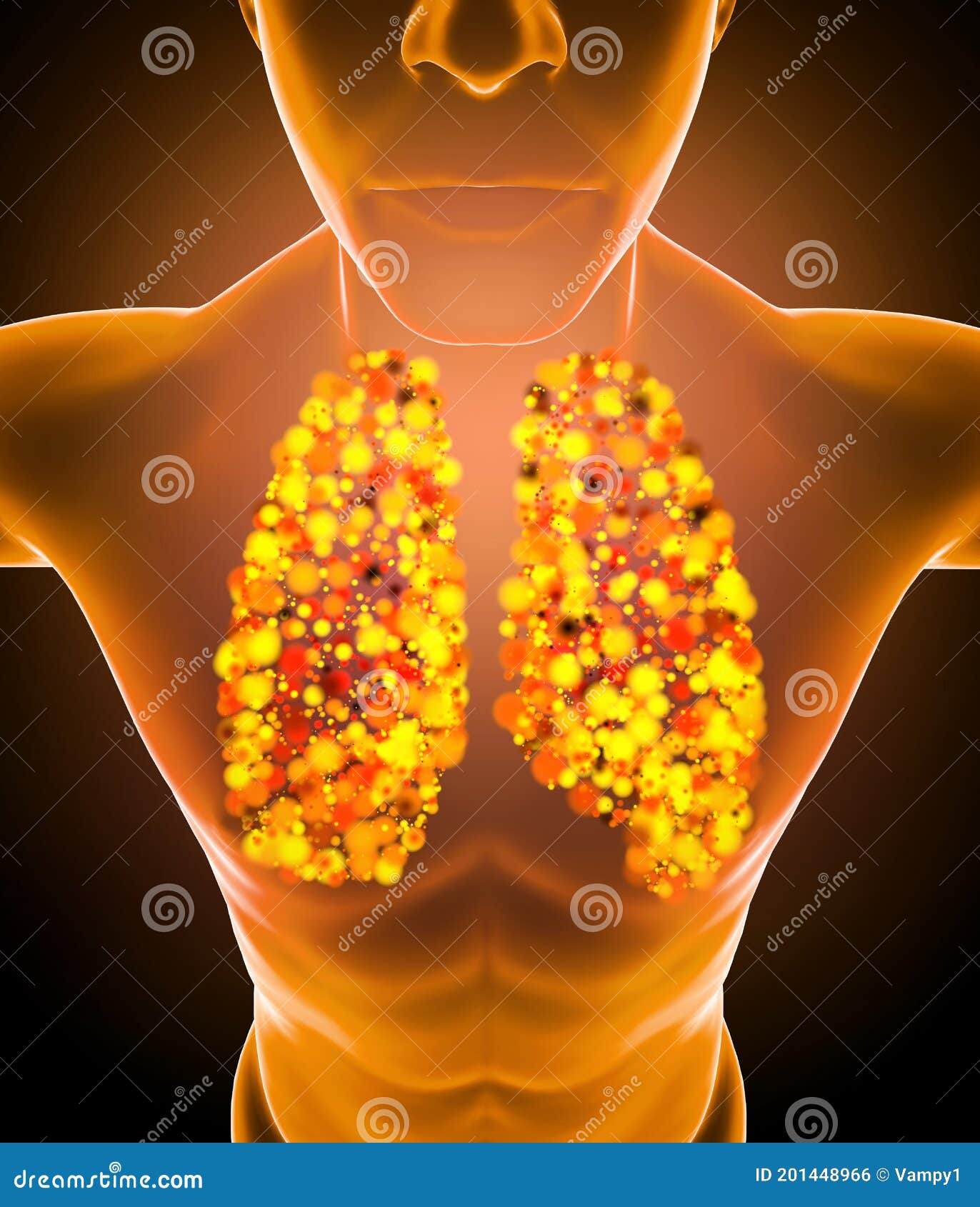 Human Anatomy, Problems with the Respiratory System, Severely Damaged ...