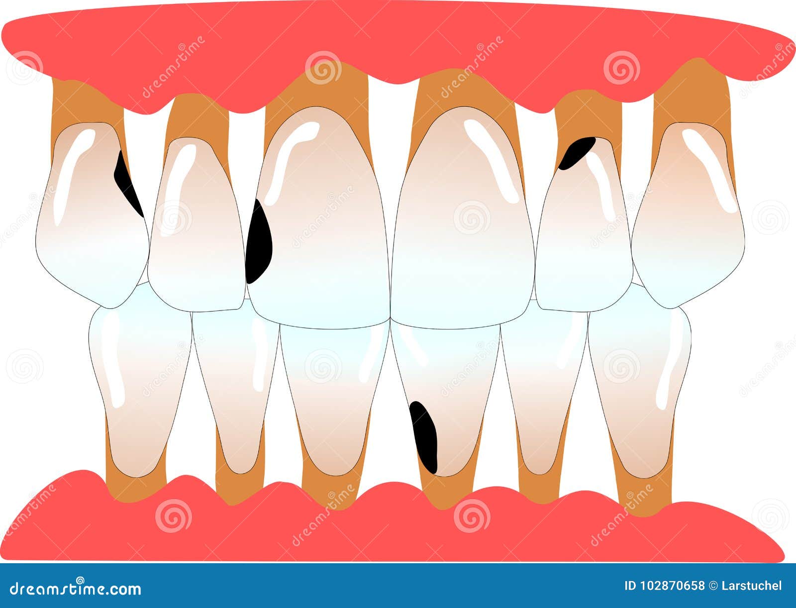 Human Anterior Teeth with Periodontitis and Caries Stock Illustration ...
