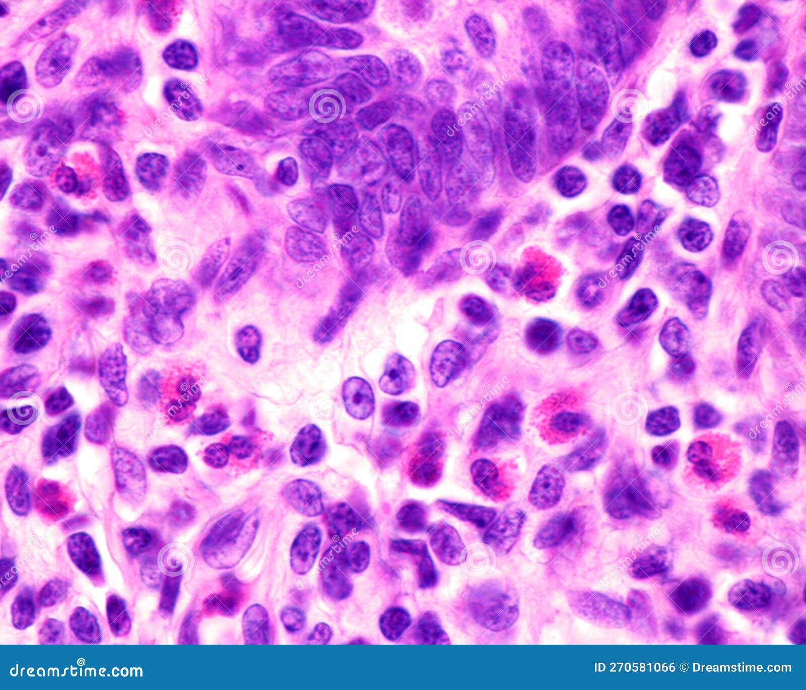 Human Appendix. Eosinophils Stock Photo - Image of allergy, eosinophil ...