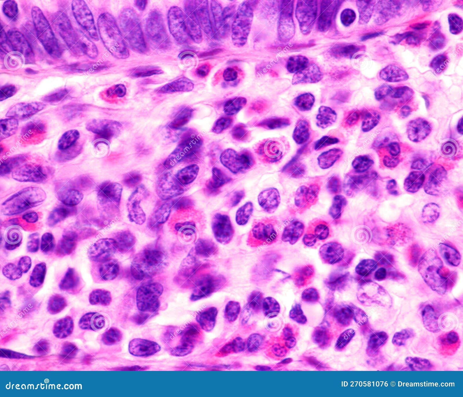 Human Appendix. Eosinophils Stock Photo - Image of microscopy, white ...