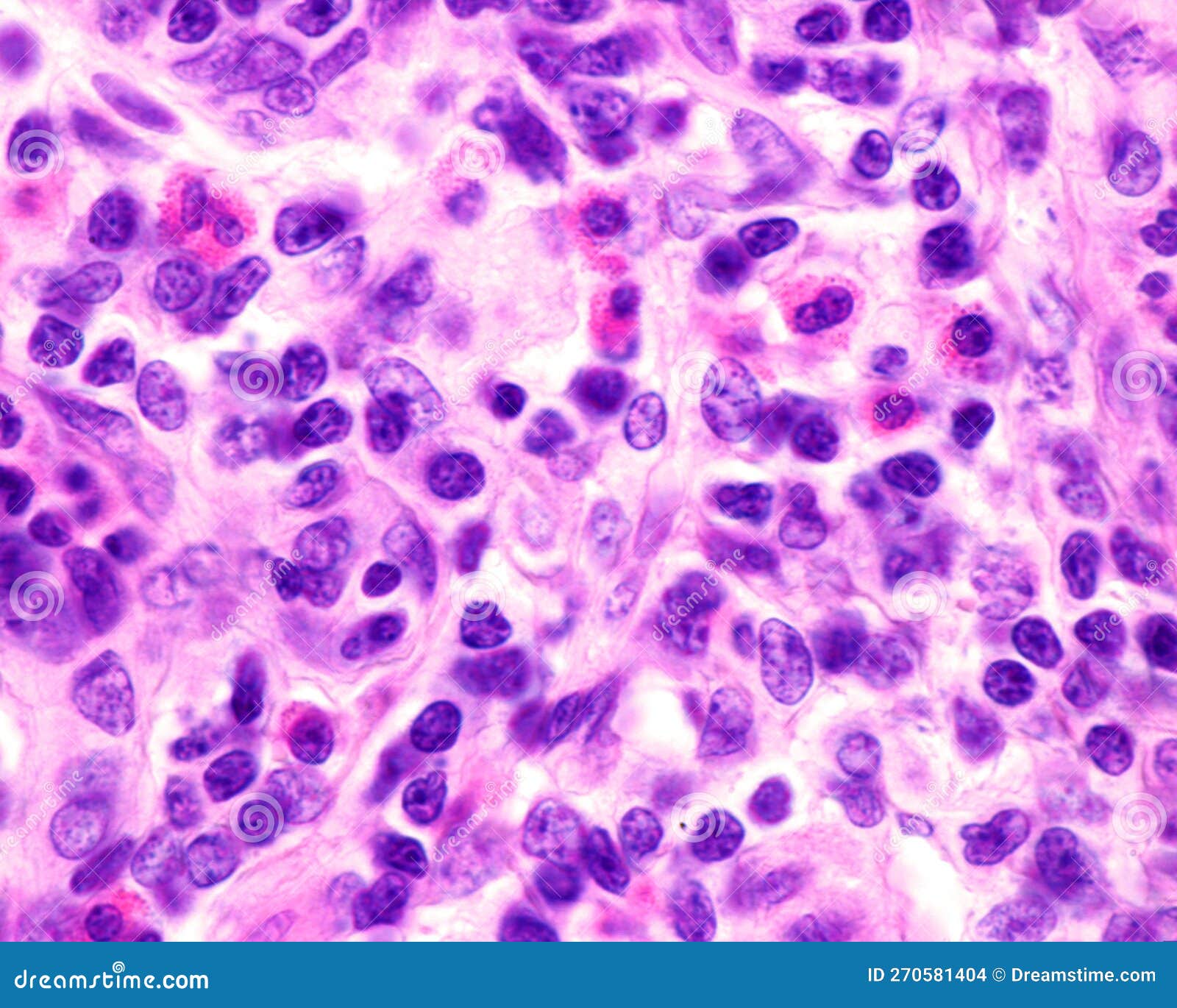 Human Appendix. Eosinophils Stock Photo - Image of white, cytoplasm ...