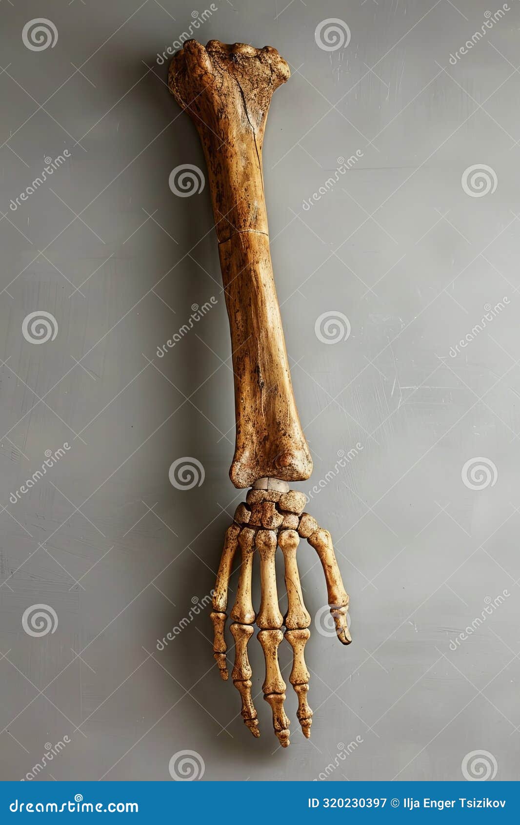 Human Arm Bone Fracture Immobilized in a Cast for Optimal Healing and ...