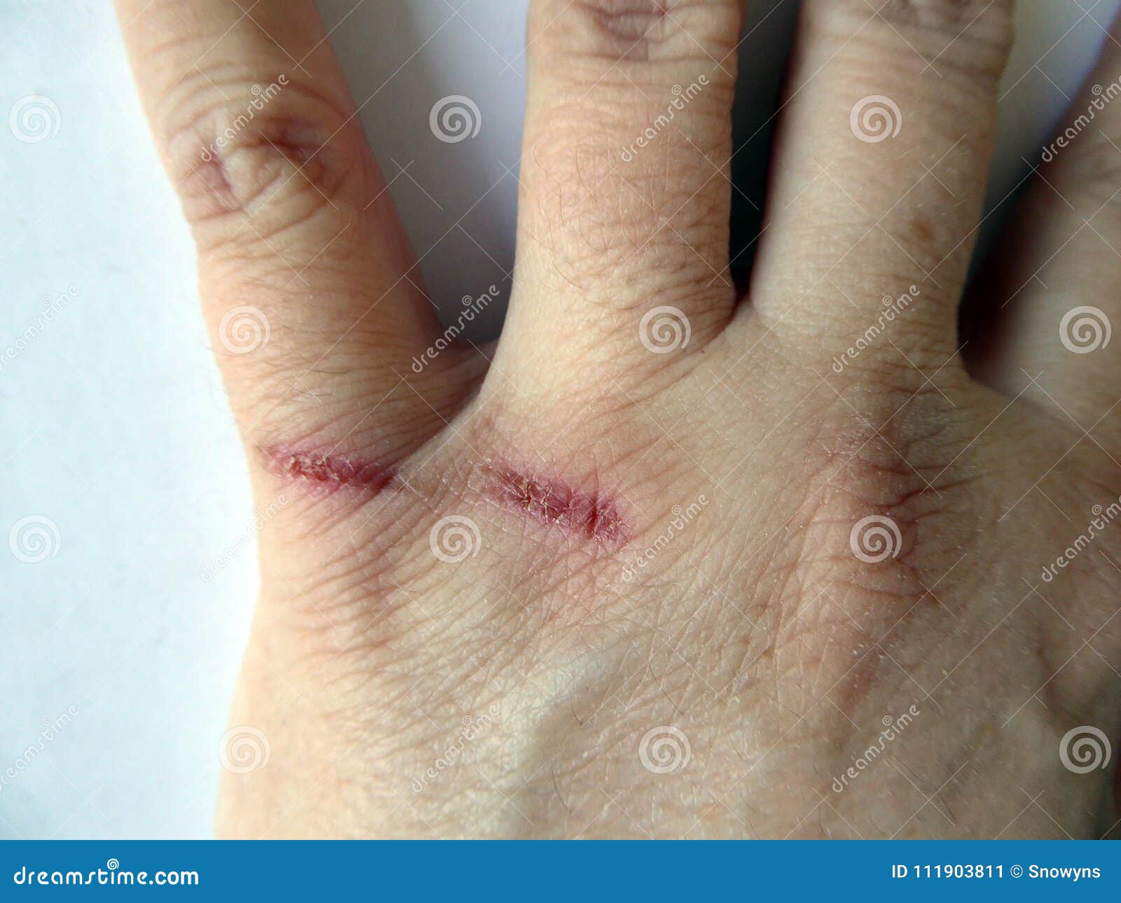 Human Arm with Scars from Burns on the Skin Stock Image - Image of care ...