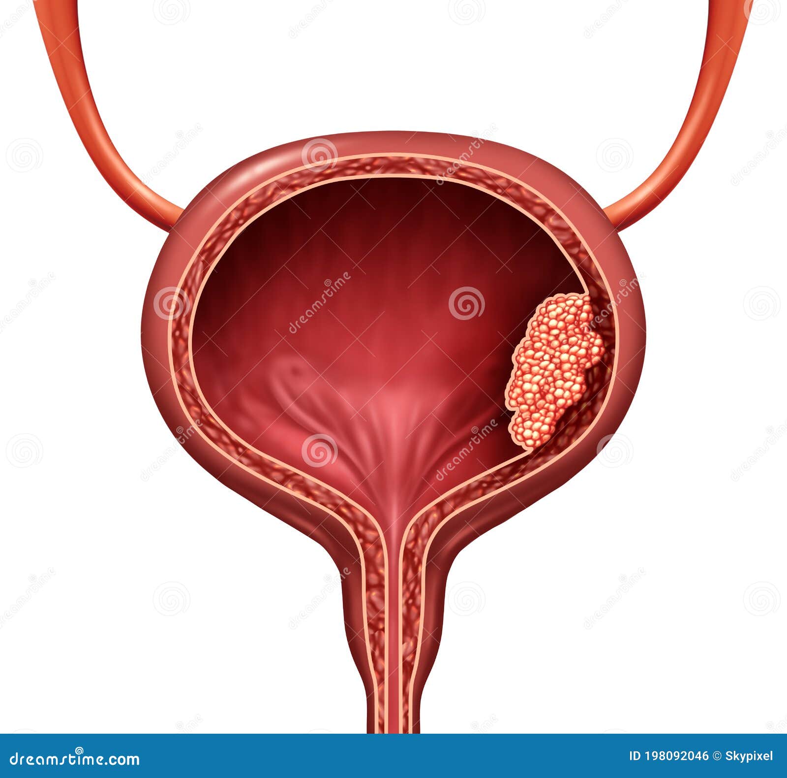 Human Bladder Illustration, Cross Section Cartoon Vector ... Human Bladder Illustration, Cross Section Cartoon Vector ...