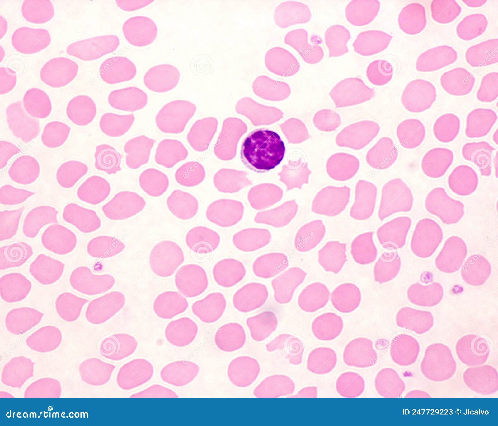 Human Blood Smear. Lymphocyte Stock Image - Image of agranulocyte ...