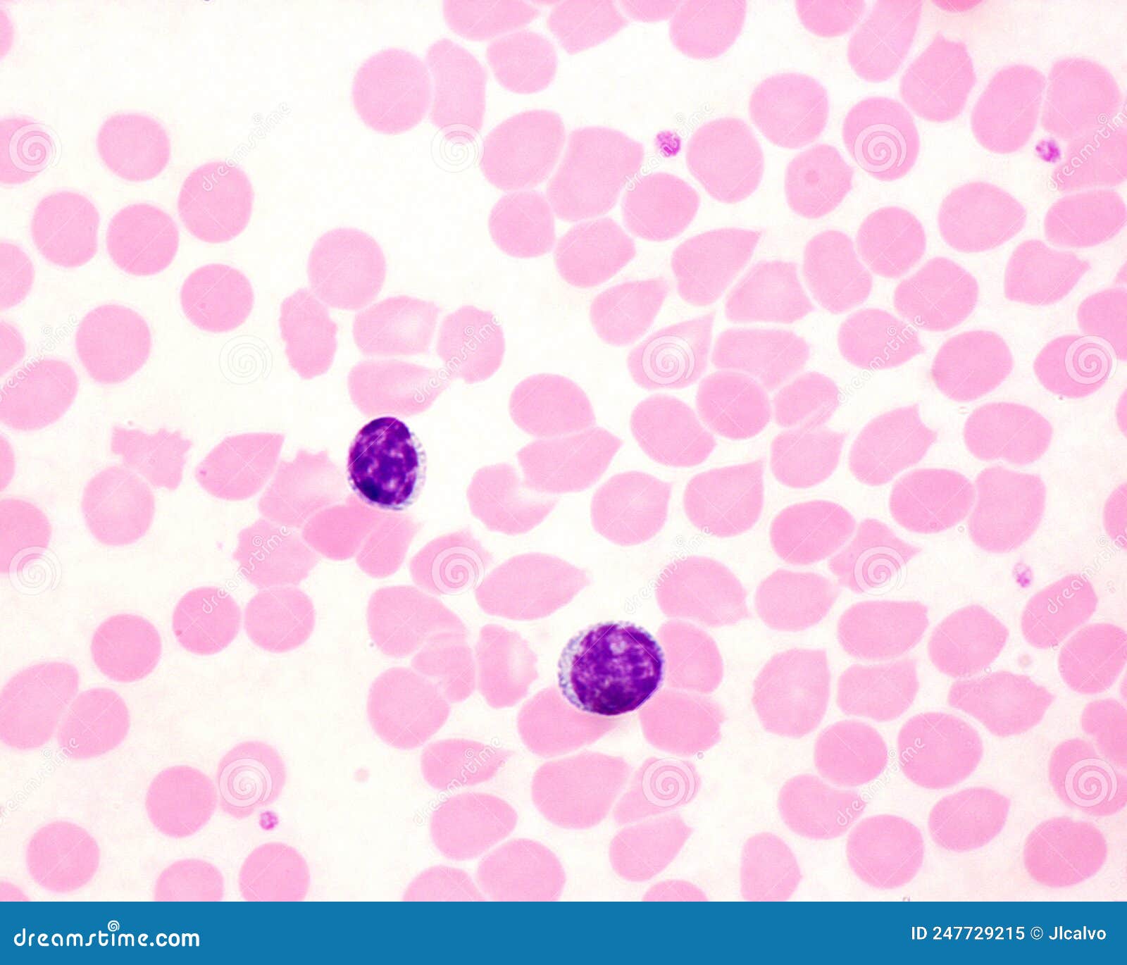 Human Blood Smear. Lymphocytes Stock Image - Image of lymphocyte ...