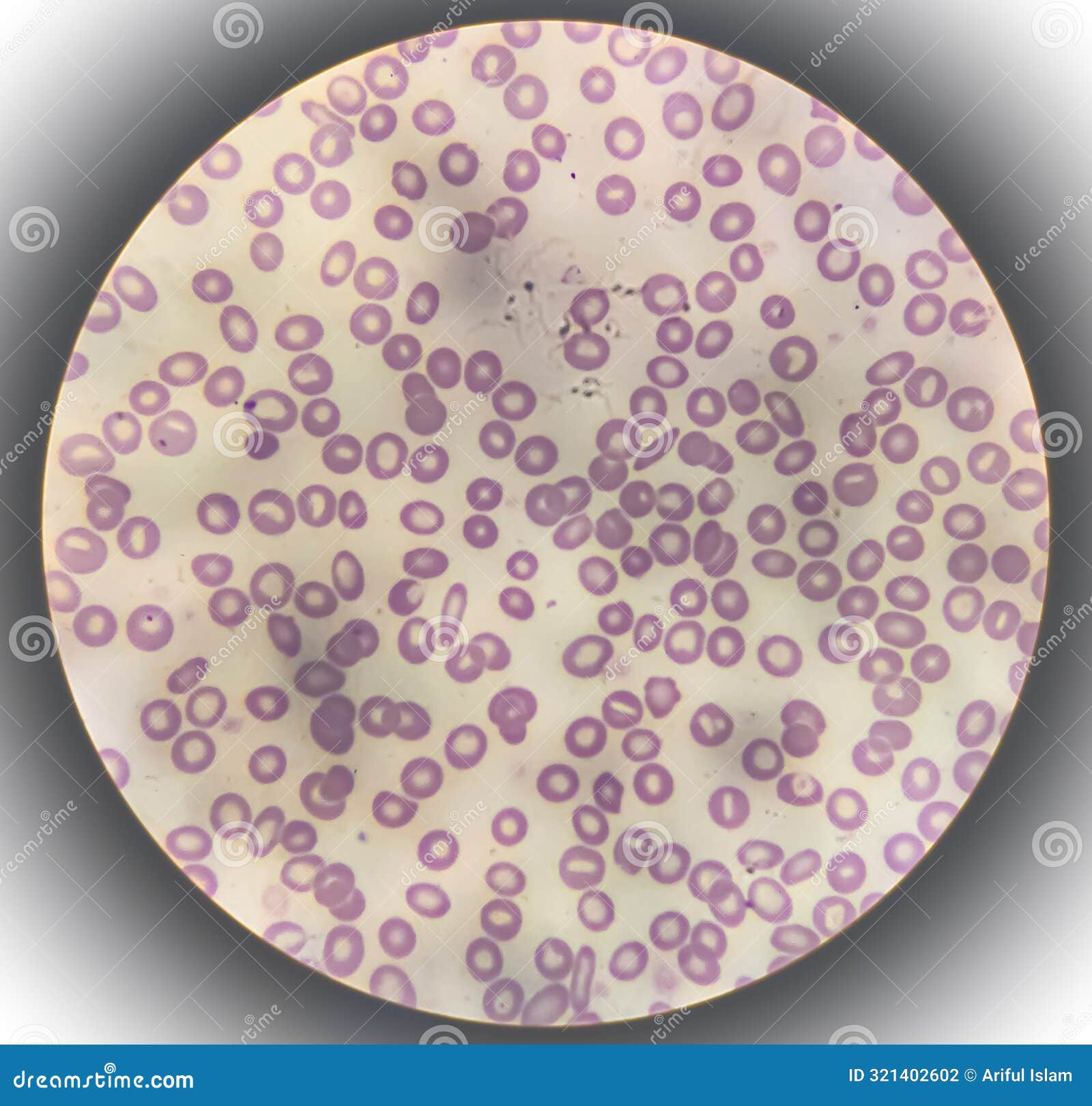 Abnormal Red Blood Cells Showing Spherocyte.Medical Science Background ...