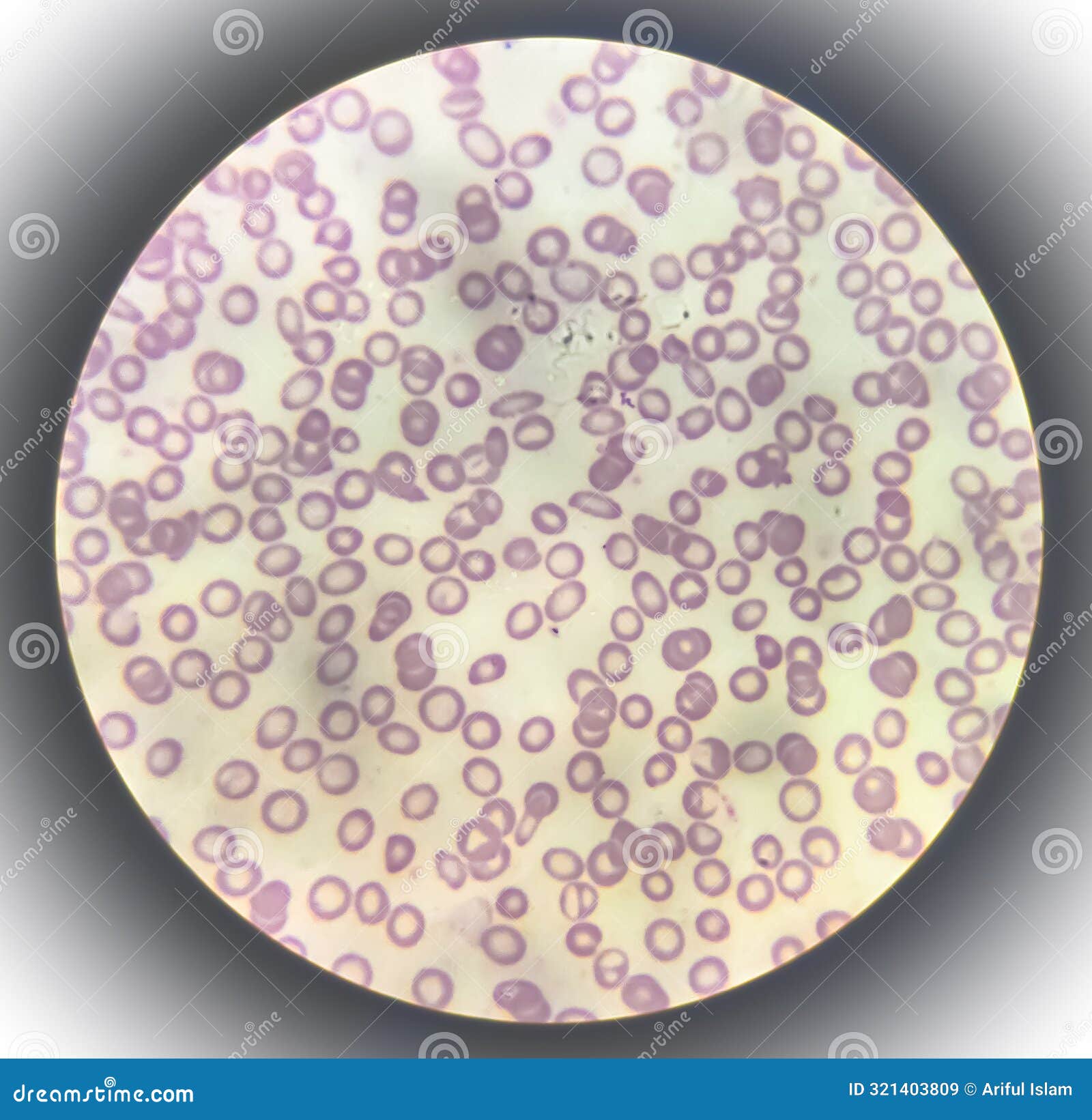Abnormal Red Blood Cells Showing Spherocyte.Medical Science Background ...