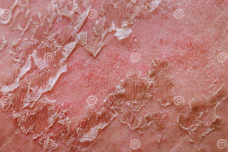 Human Body Develops Irritated Reddened Skin with Flaking Cell Scales ...