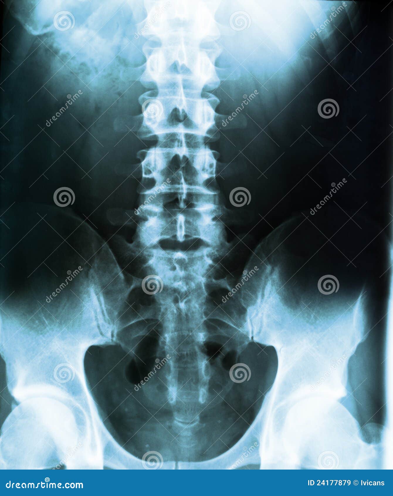 Human Body On X-ray Royalty Free Stock Images - Image: 24177879