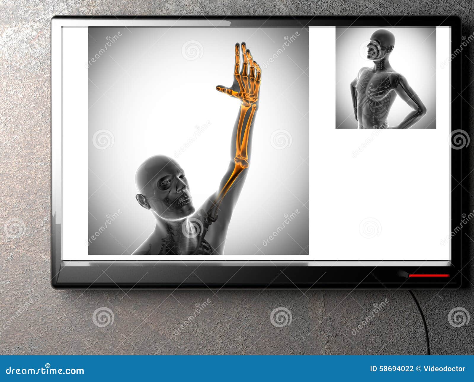 Human Bones Radiography Scan Image Stock Photo - Image of examination ...