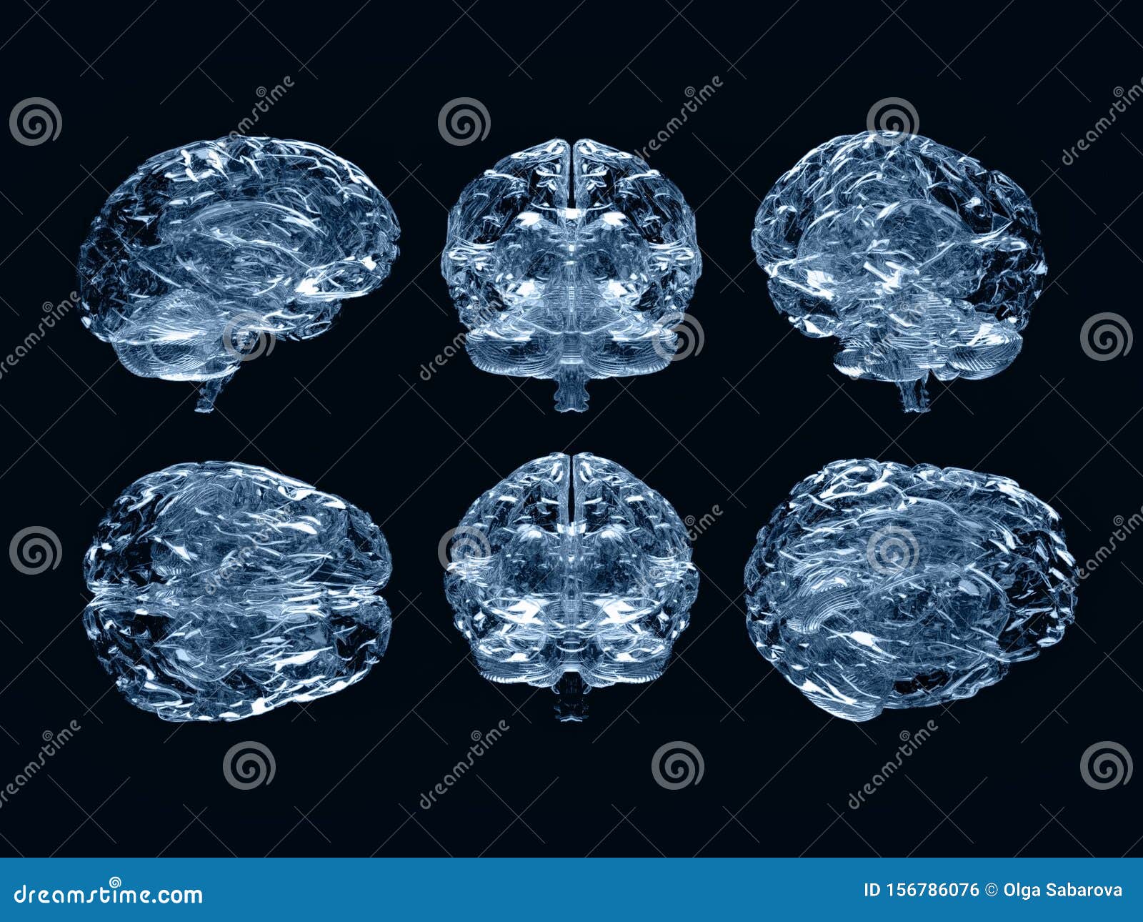 MRA AND MRV OF BRAIN Multiple Acute Intracranial Hemorrhage At ...