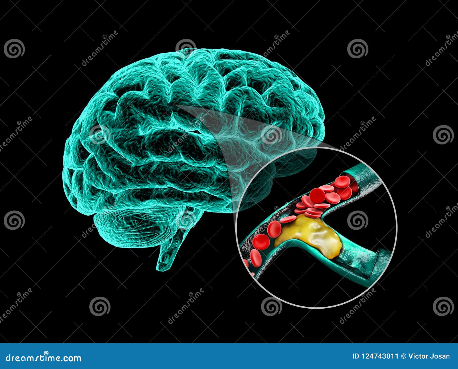 Human Brain with Cerebral Sclerosis. Human Brain Anatomy 3d ...