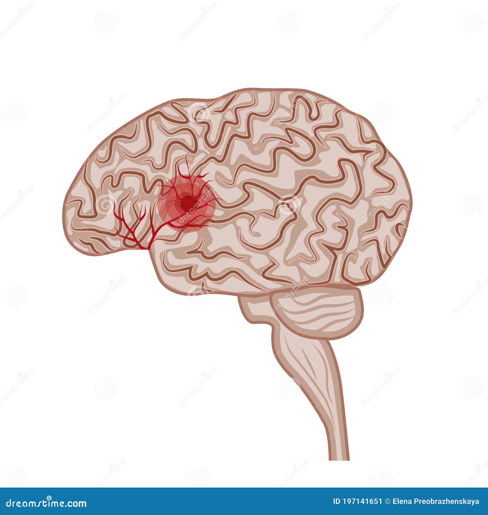 Cartoon Brain Lesion