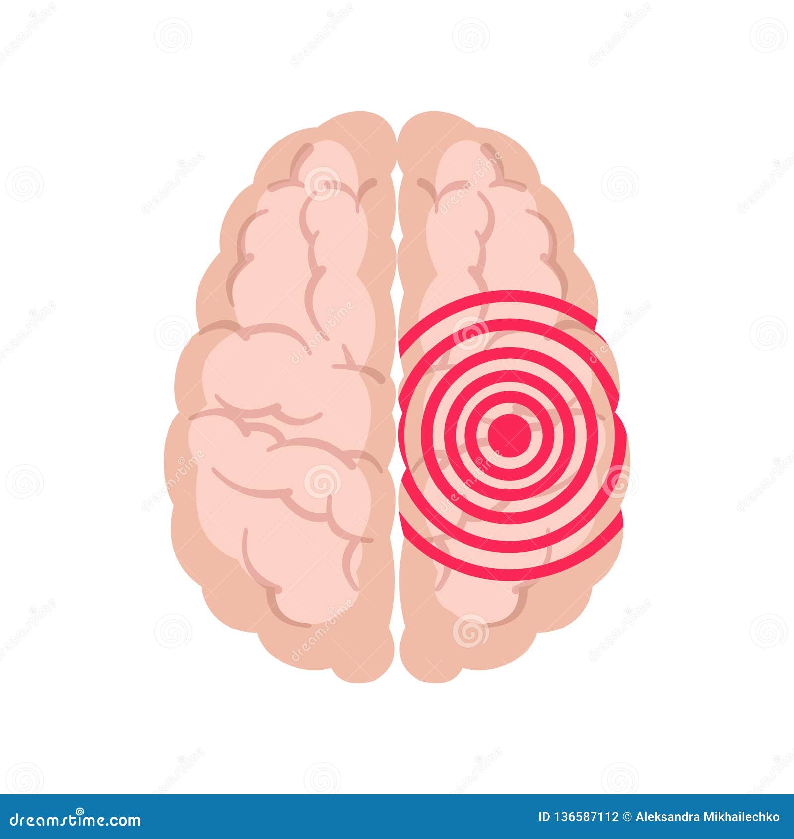 Human Brain with Epilepsy Activity Isolated on White Background Stock ... Human Brain with Epilepsy Activity Isolated on White Background Stock ...