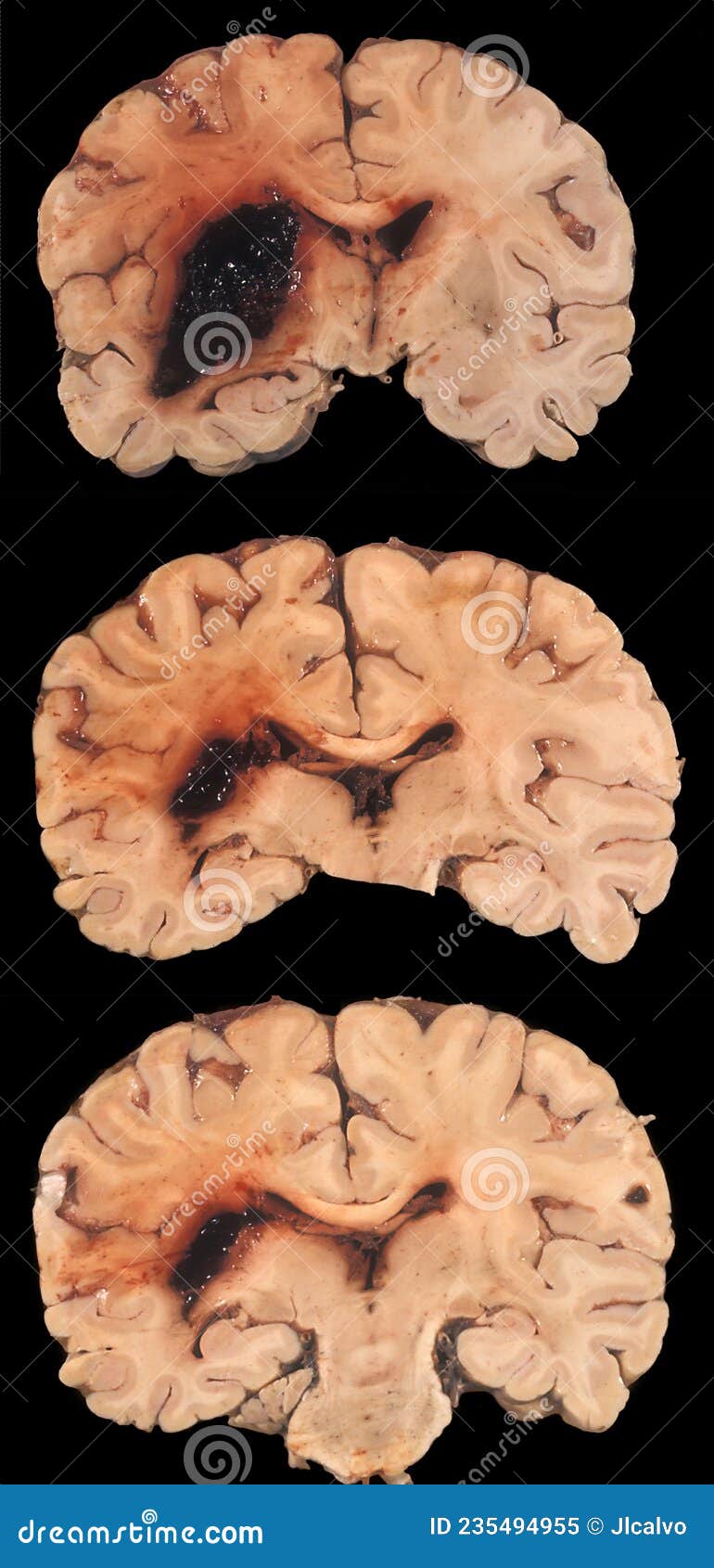 Human Brain. Hemorrhagic Infarct Stock Image - Image of anatomical ...