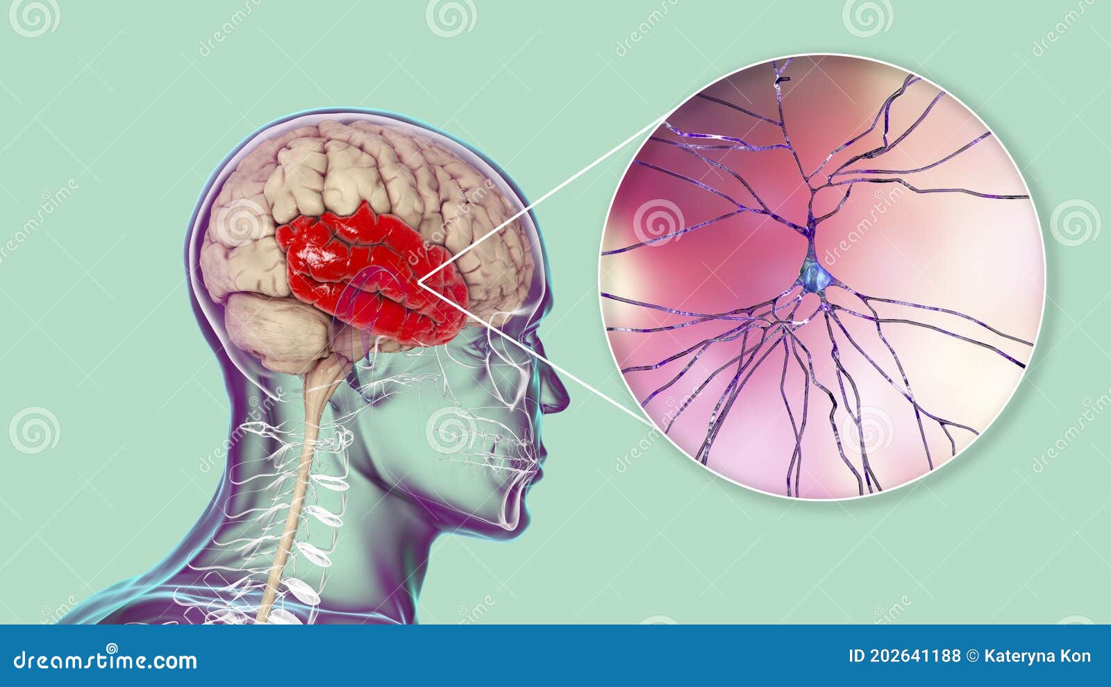 Human Brain With Highlighted Temporal Lobe And Close-up View Of Neurons ...