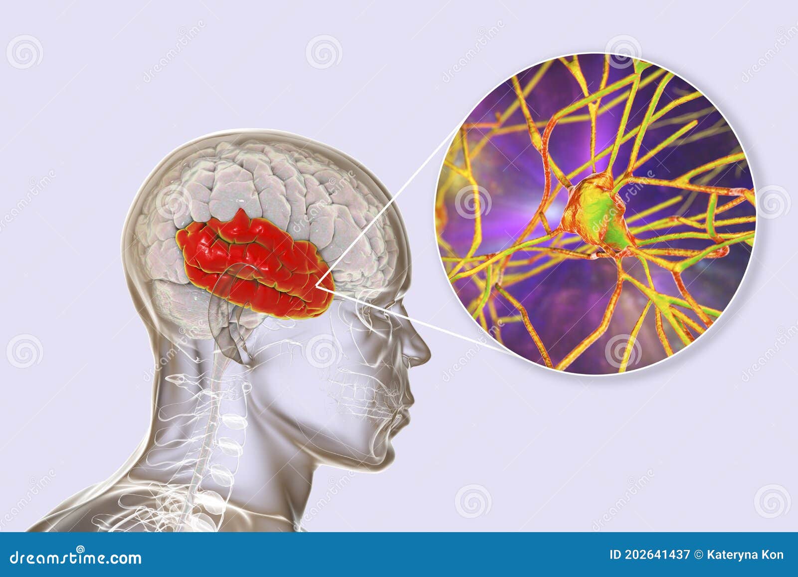 Human Brain with Highlighted Temporal Lobe and Close-up View of Neurons ...