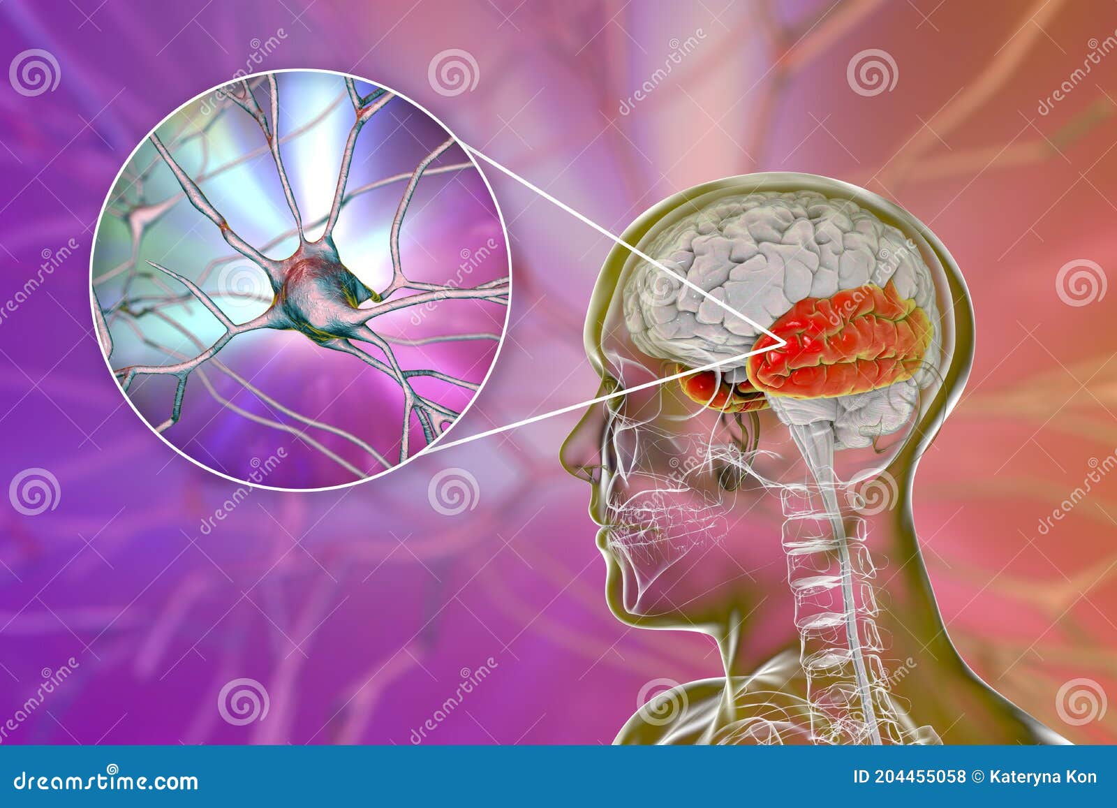 Human Brain With Highlighted Temporal Lobe And Close-up View Of Neurons ...