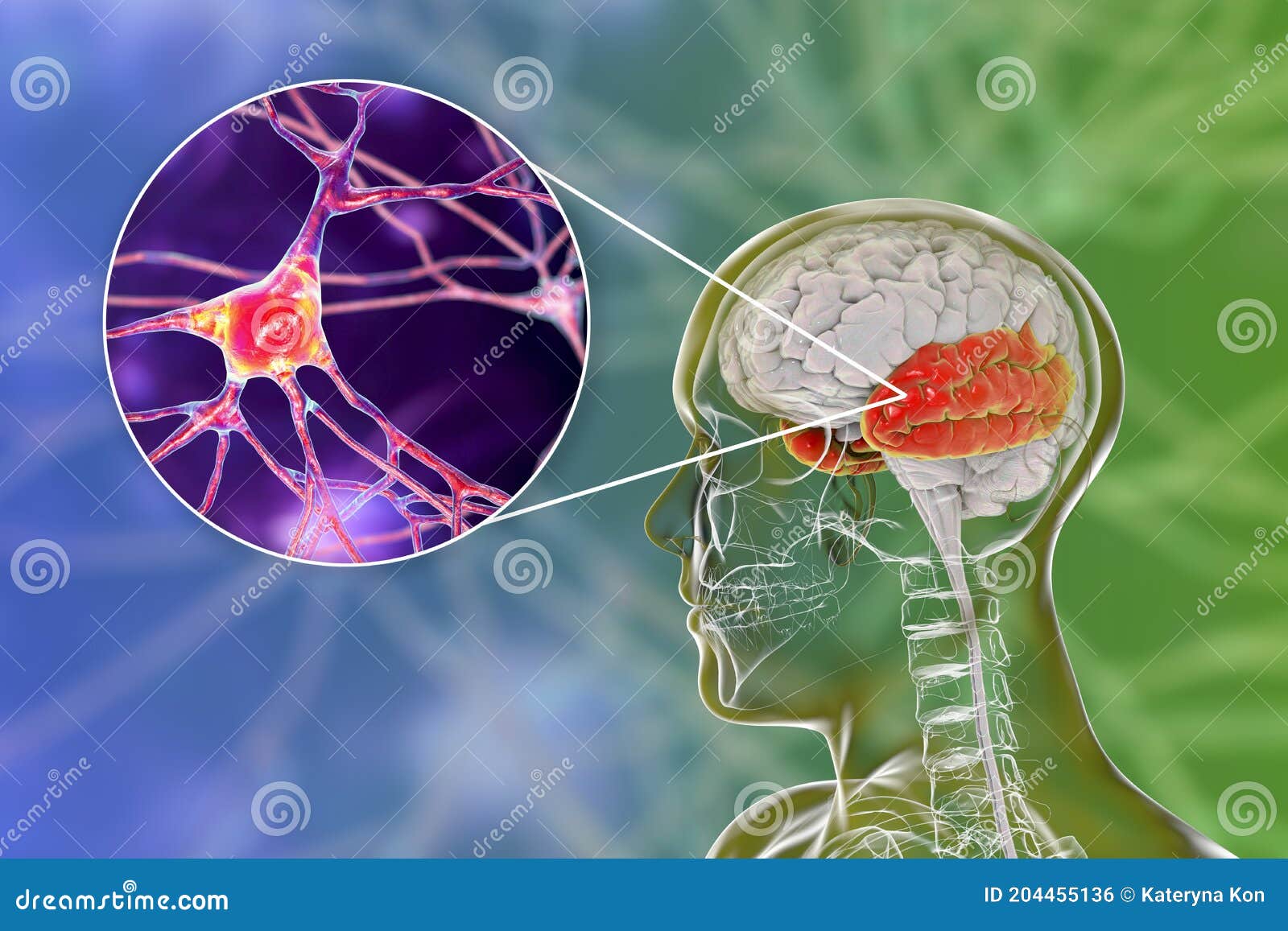 Human Brain With Highlighted Temporal Lobe And Close-up View Of Neurons ...