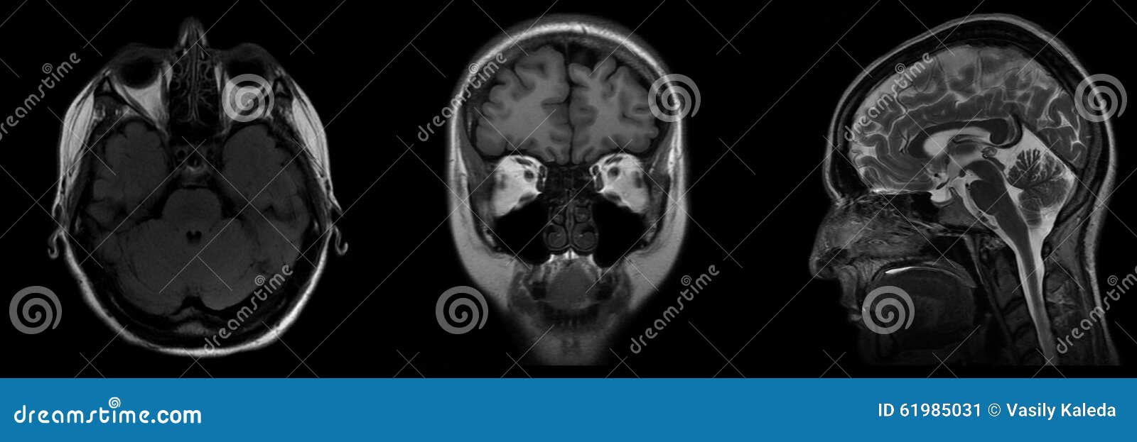 Transverse Brain Mri