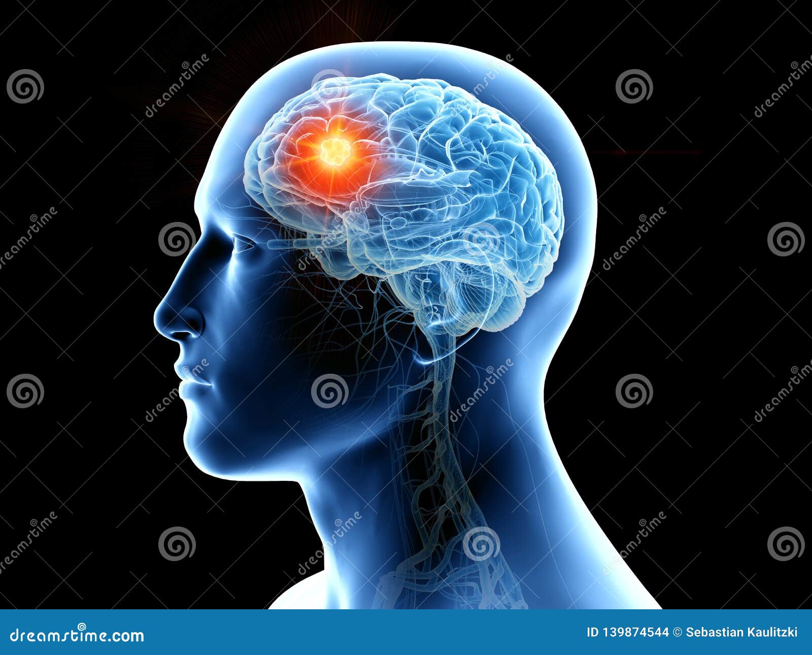 The Human Brain and a Tumor Stock Illustration - Illustration of ...