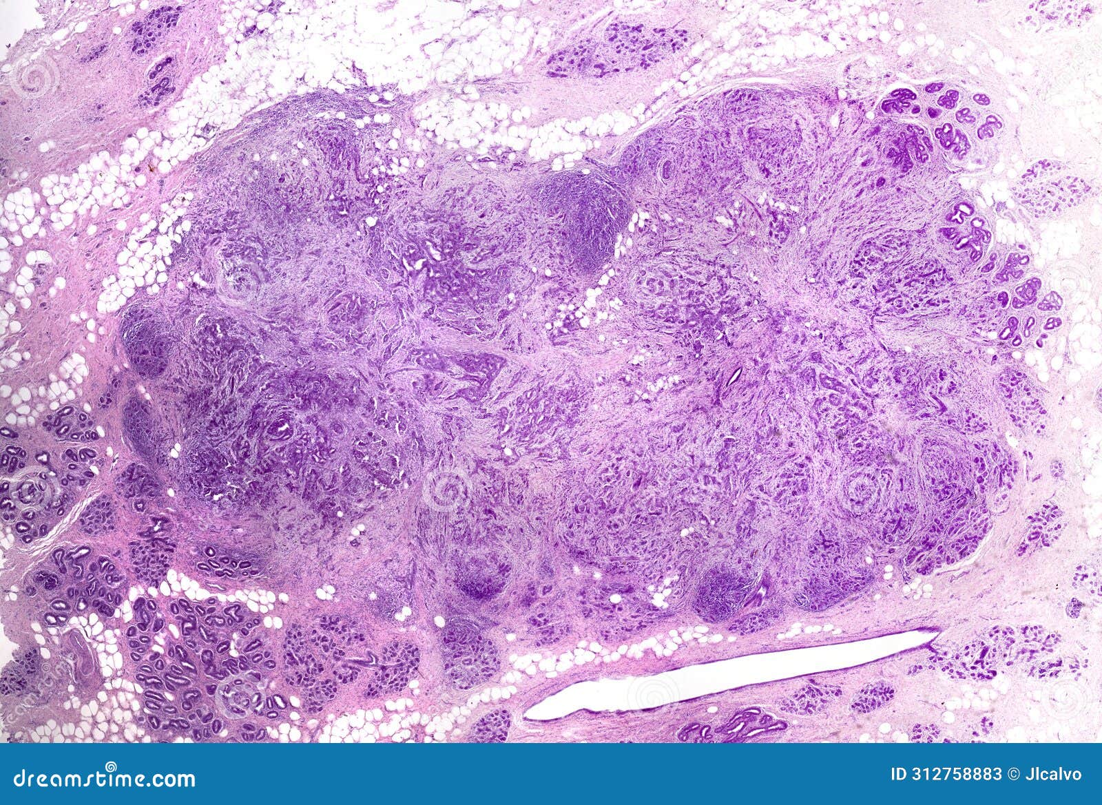 Ductal Carcinoma. Detailed Breast Medical Anatomy With Lactiferous ... Ductal Carcinoma. Detailed Breast Medical Anatomy With Lactiferous ...