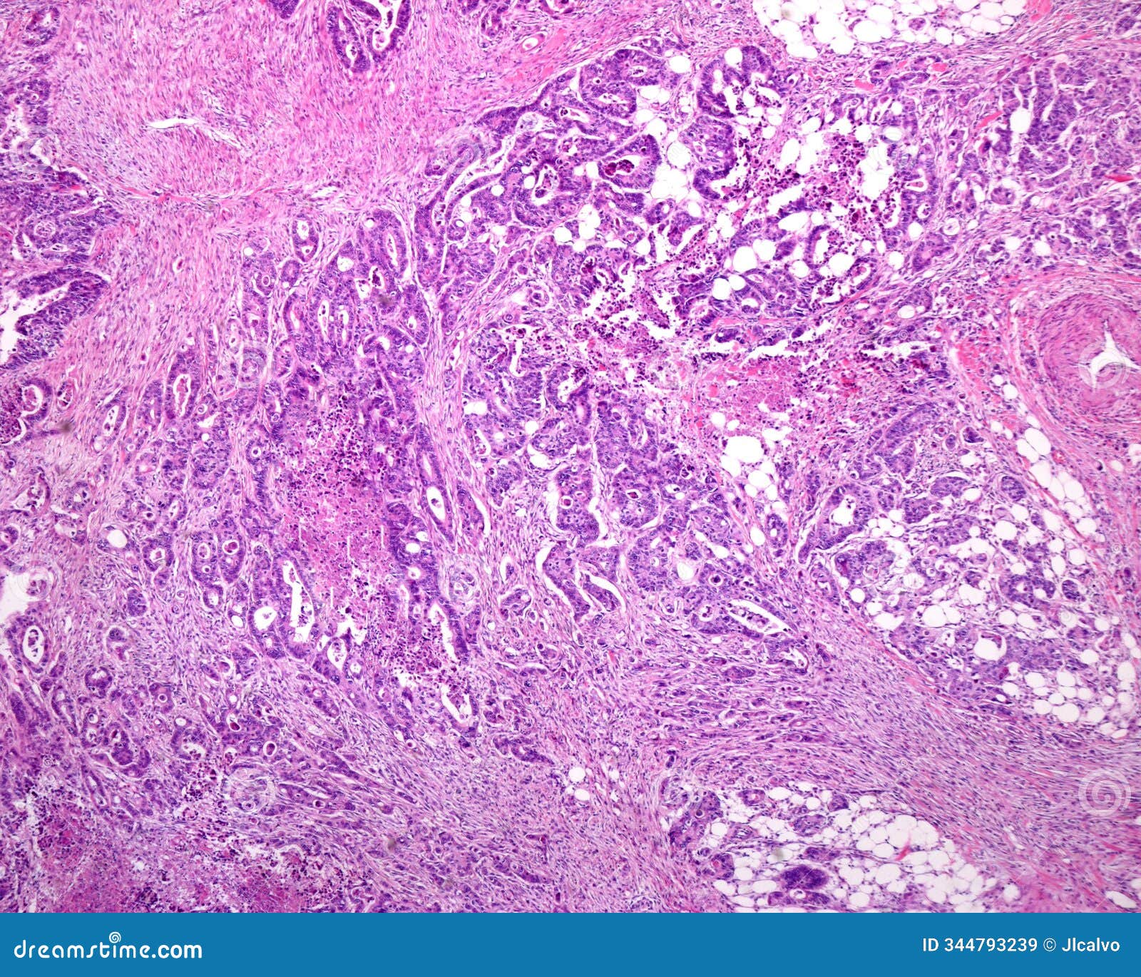 Human Breast. Malignant Carcinoma Stock Image - Image of ...