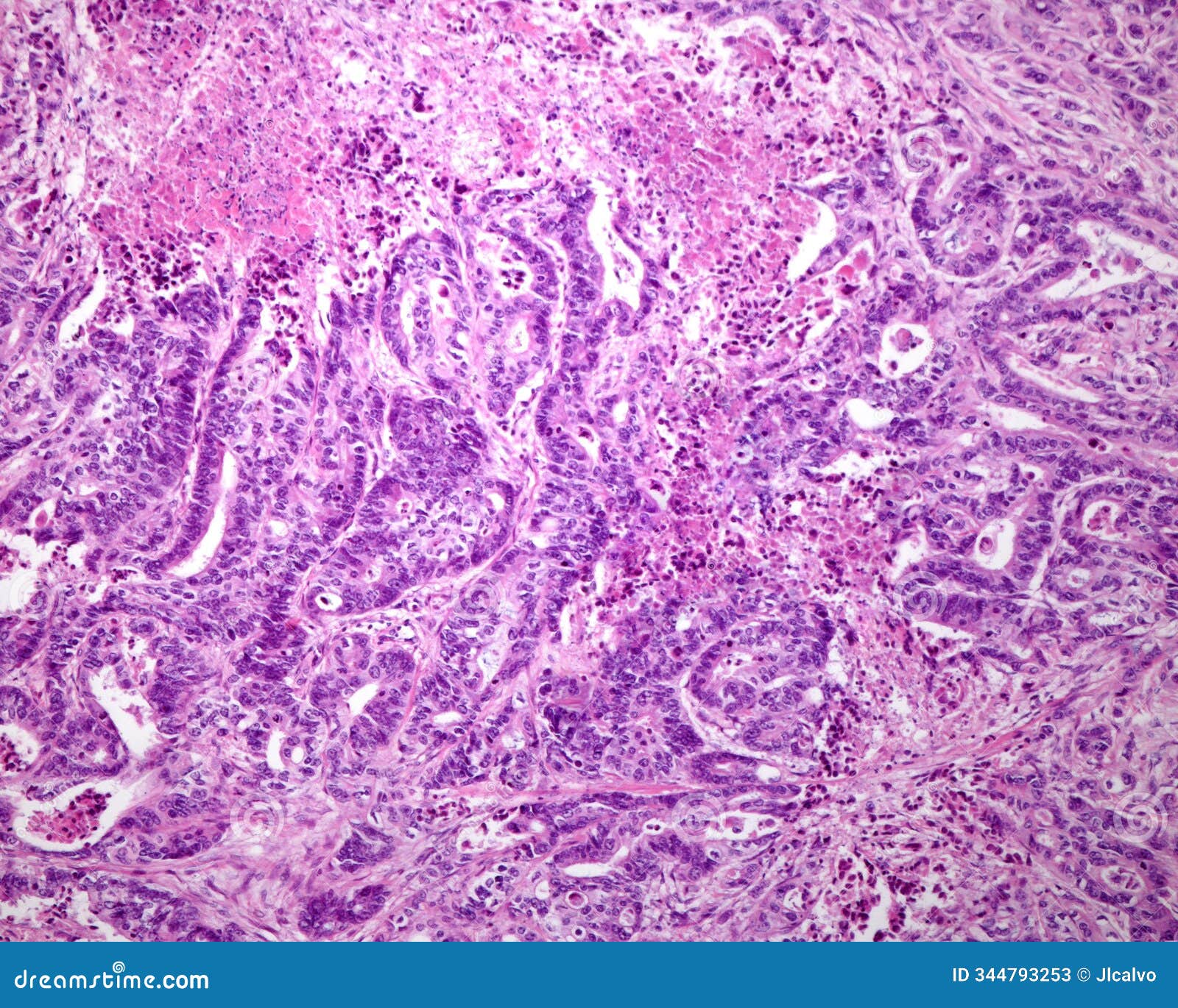 Human Breast. Malignant Carcinoma Stock Image - Image of invasive ...