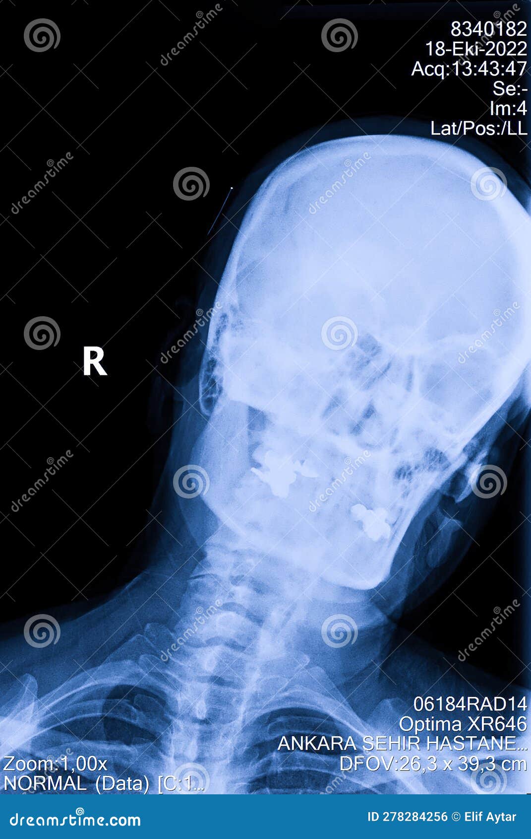 Human Cervical Spine X-ray, Neck Radiography Stock Photo - Image of collar, vertebral: 278284256