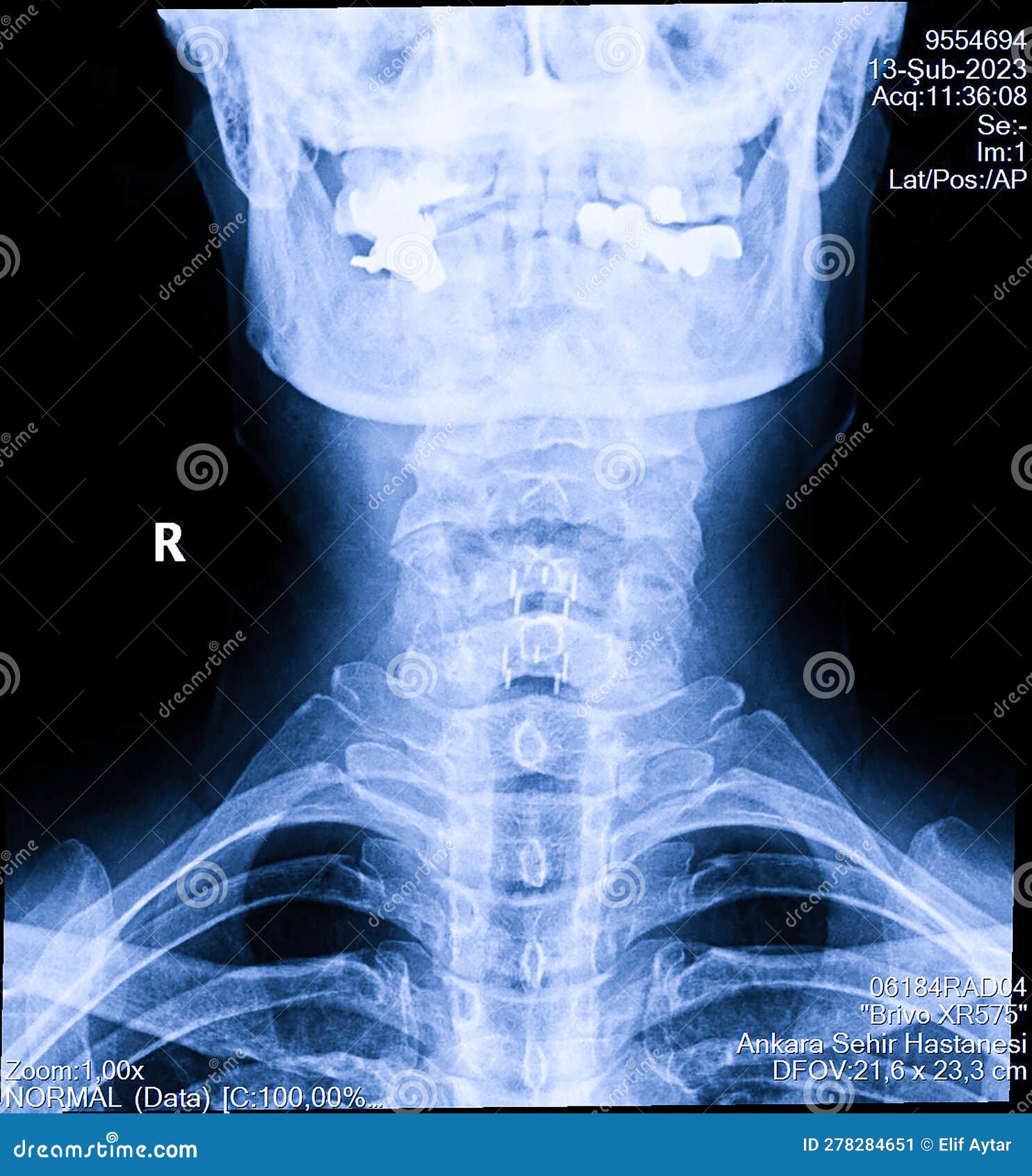 Human Cervical Spine X-ray, Neck Radiography Stock Image - Image of ...