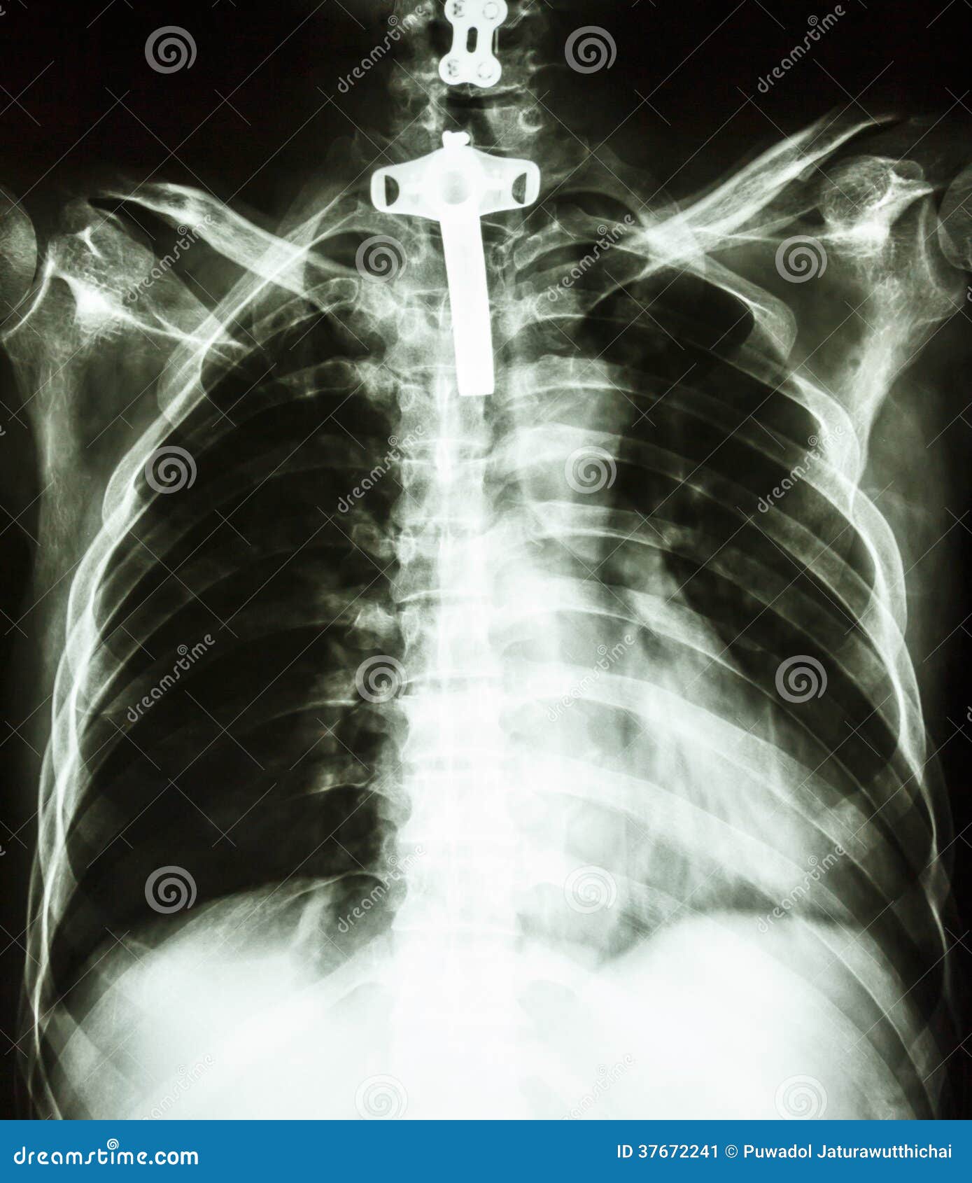 Human Chest with Tracheotomy Tube Stock Image - Image of adult ...