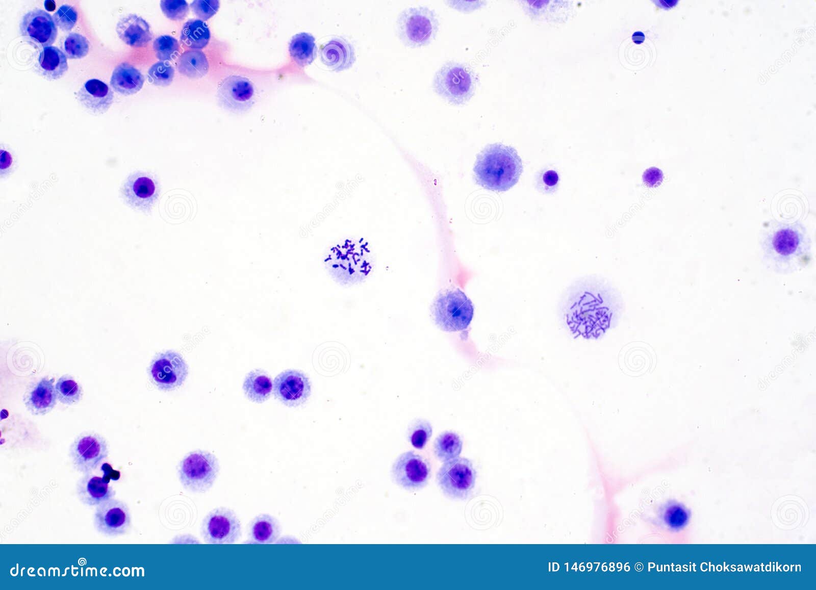 Human Chromosomes from Blood Under Microscope View Stock Photo - Image ...
