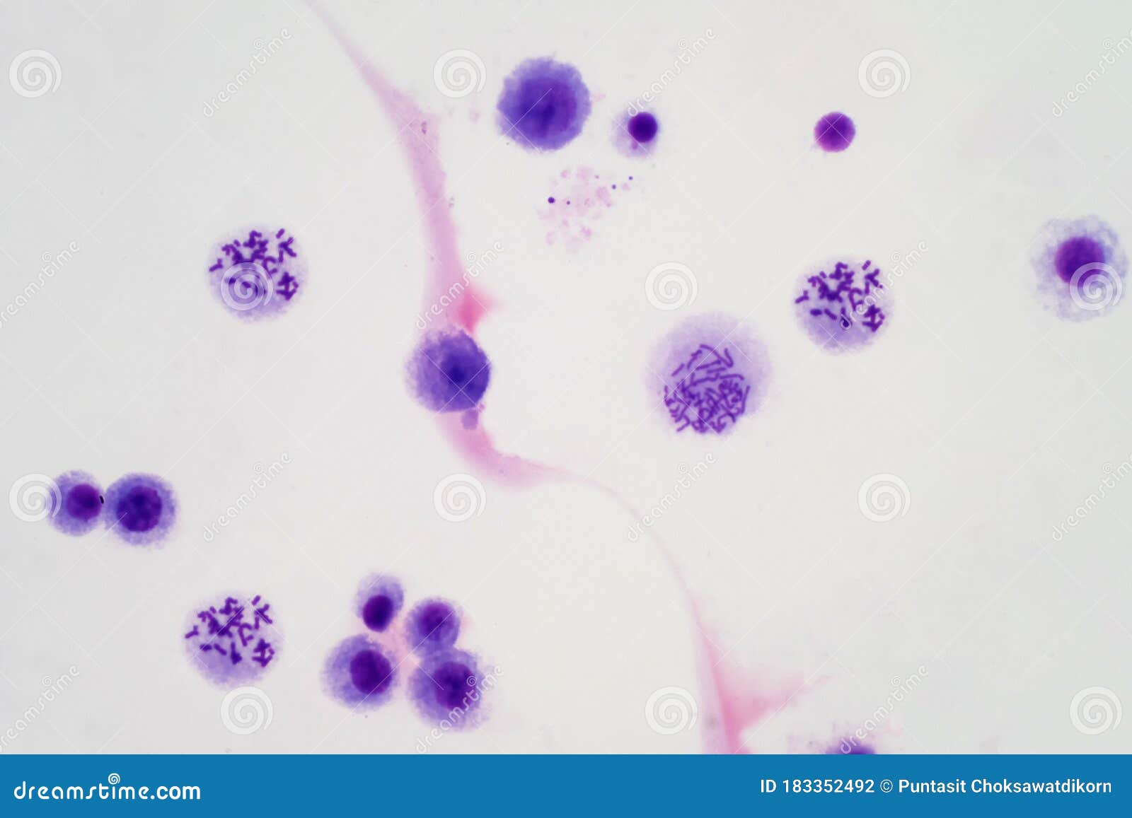 Human Chromosomes from Blood Under Microscope View Stock Photo - Image ...
