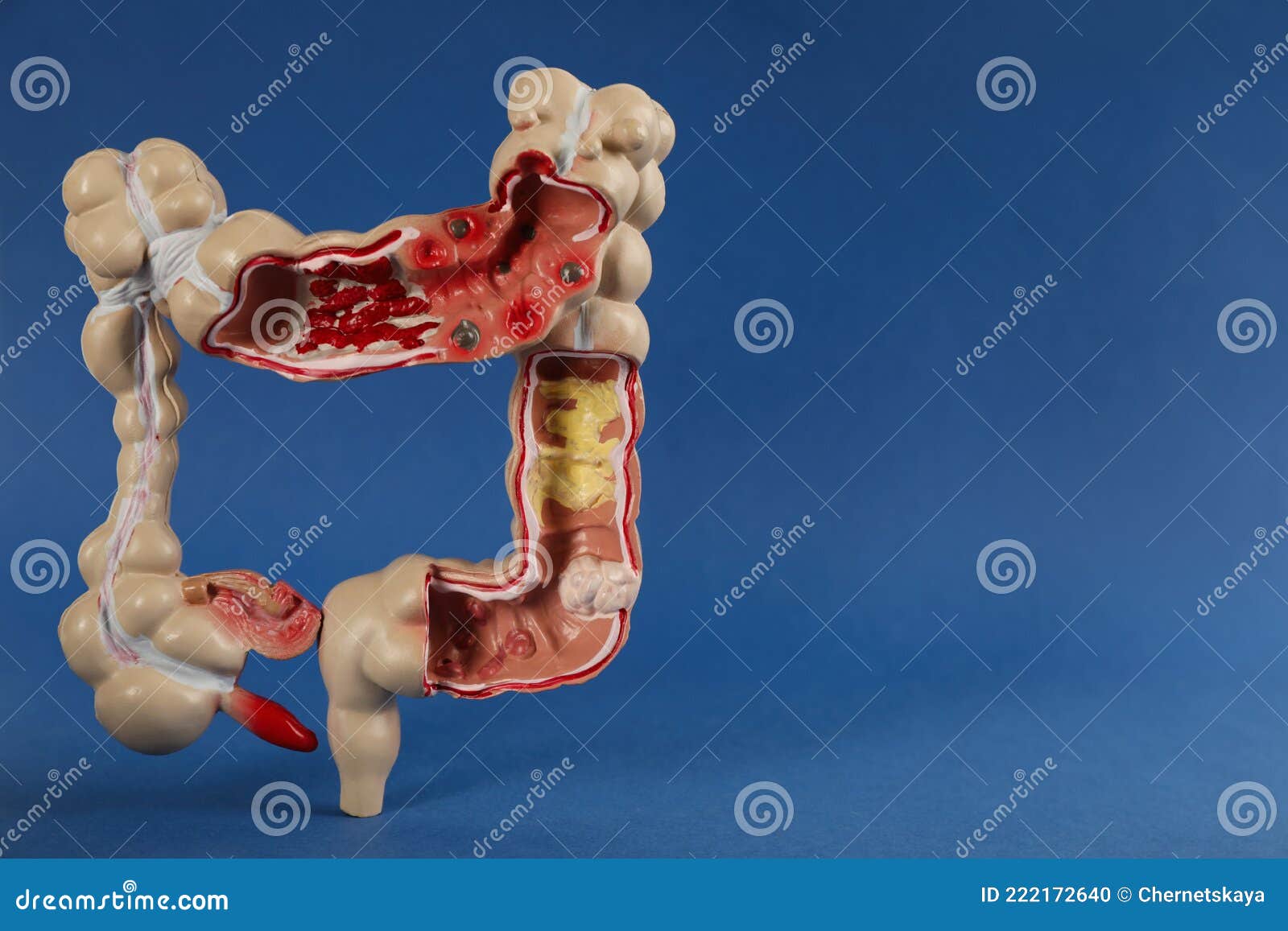 Human Colon Model on Blue Background. Space for Text Stock Photo ...