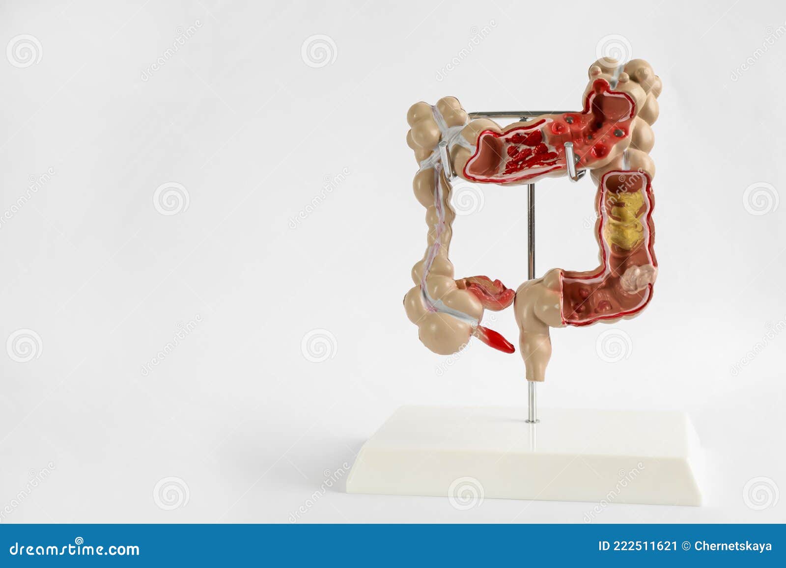 Human Colon. Large Intestine Wall Royalty-Free Stock Photography ...
