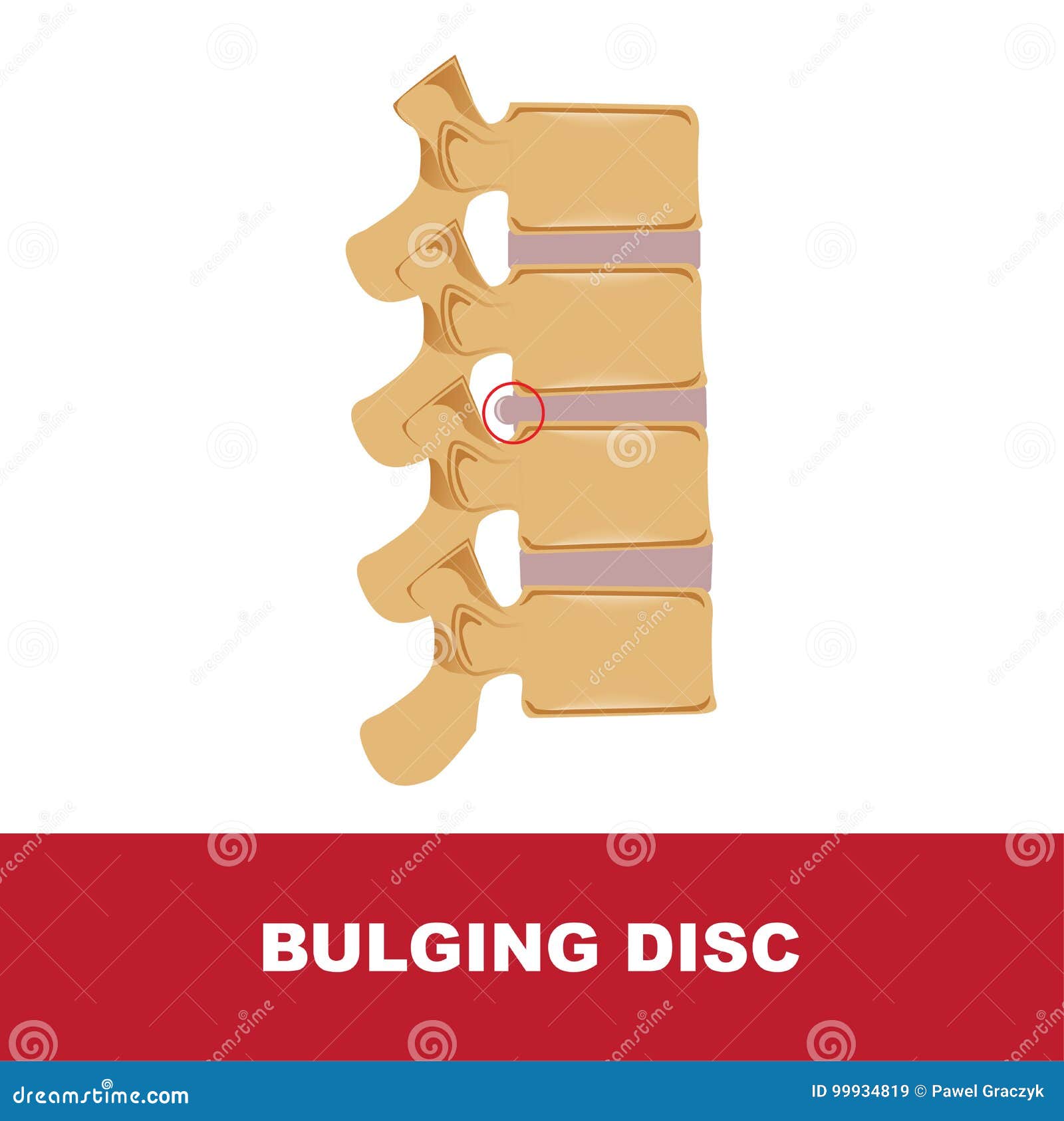 Disc Degeneration Flat Illustration Vector Diagram With Condition ...
