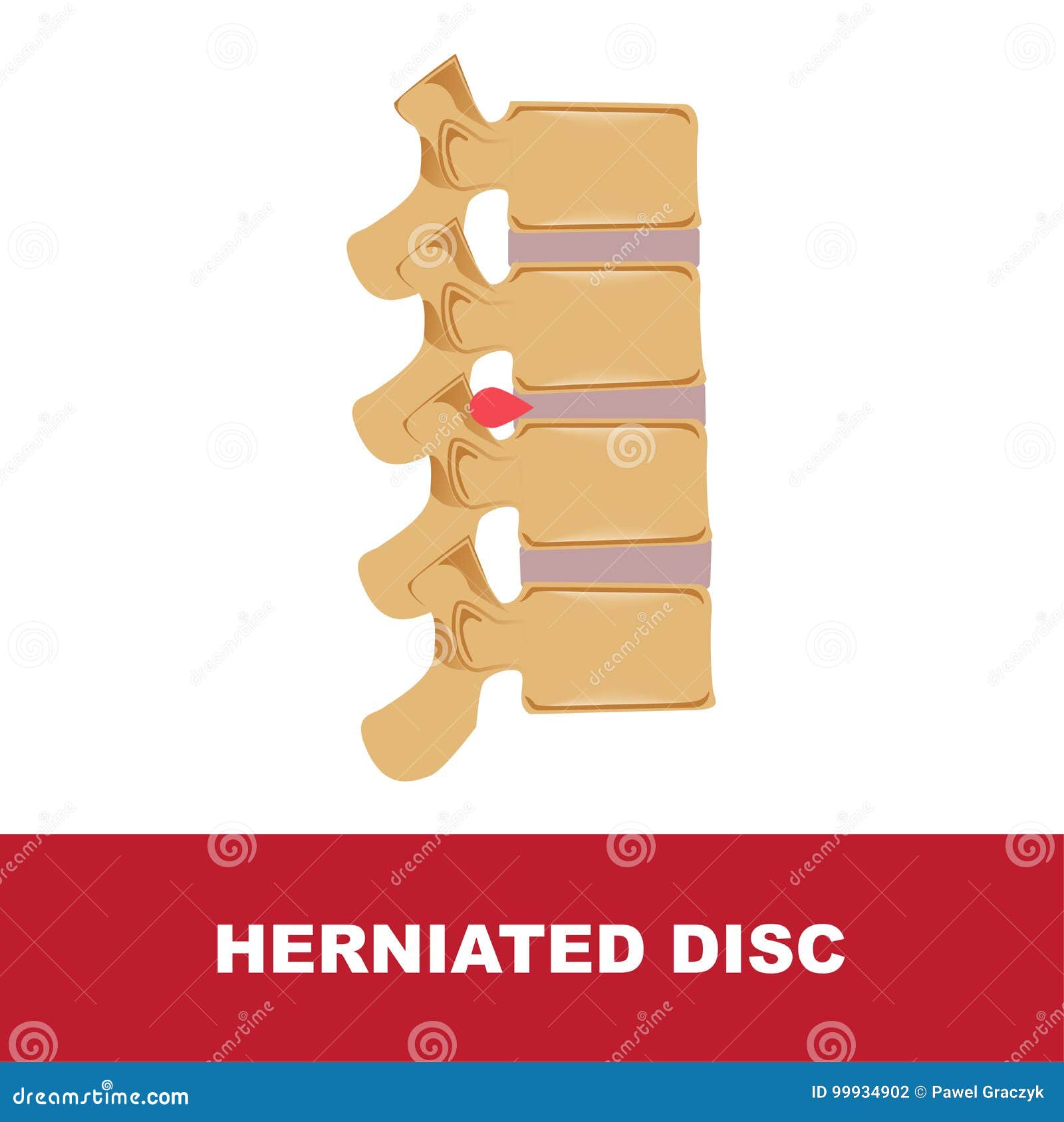 Herniated Disc Illustration Stock Vector - Illustration of process ...