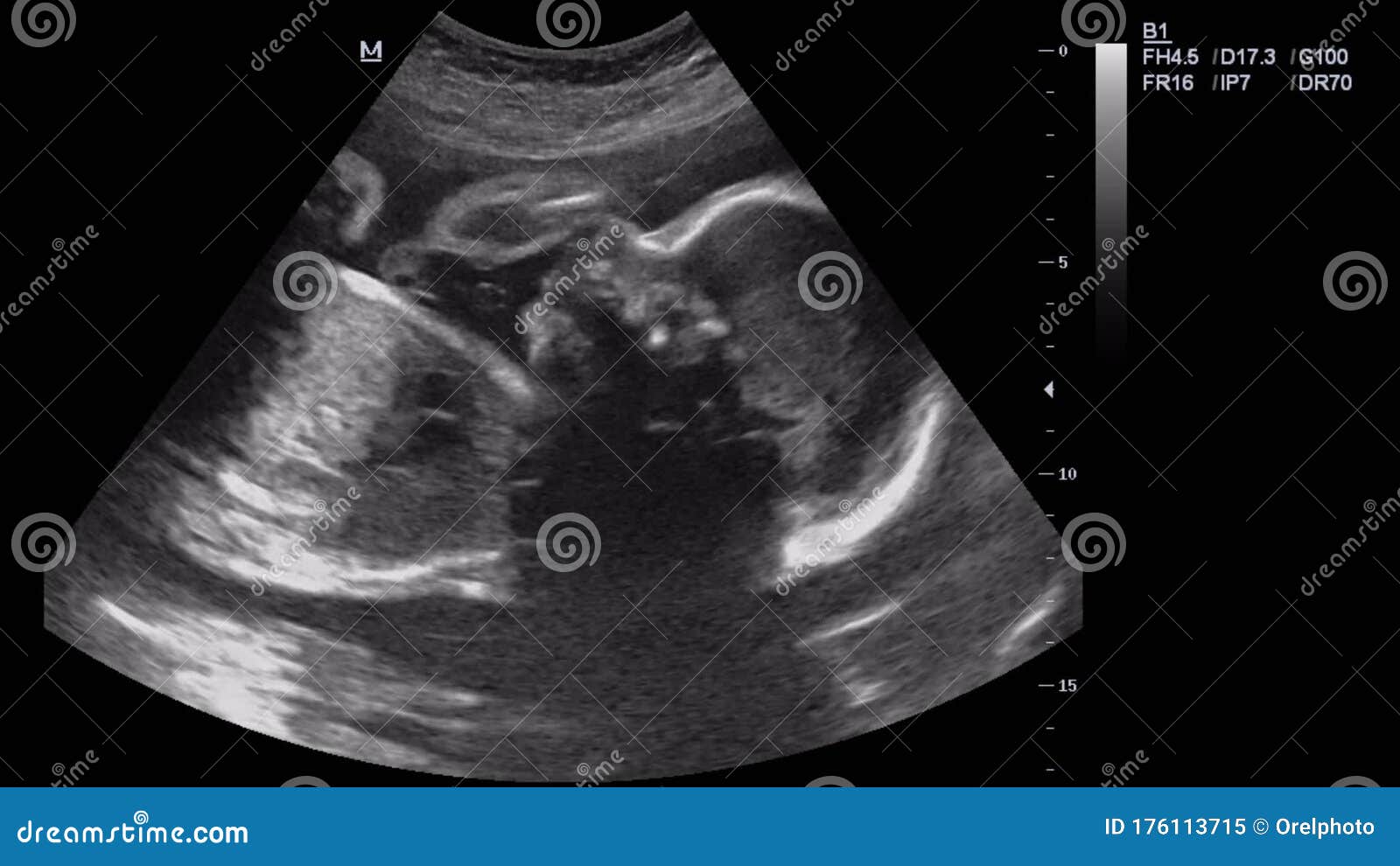 Human Embryo on an Ultrasound Display Stock Video - Video of ...