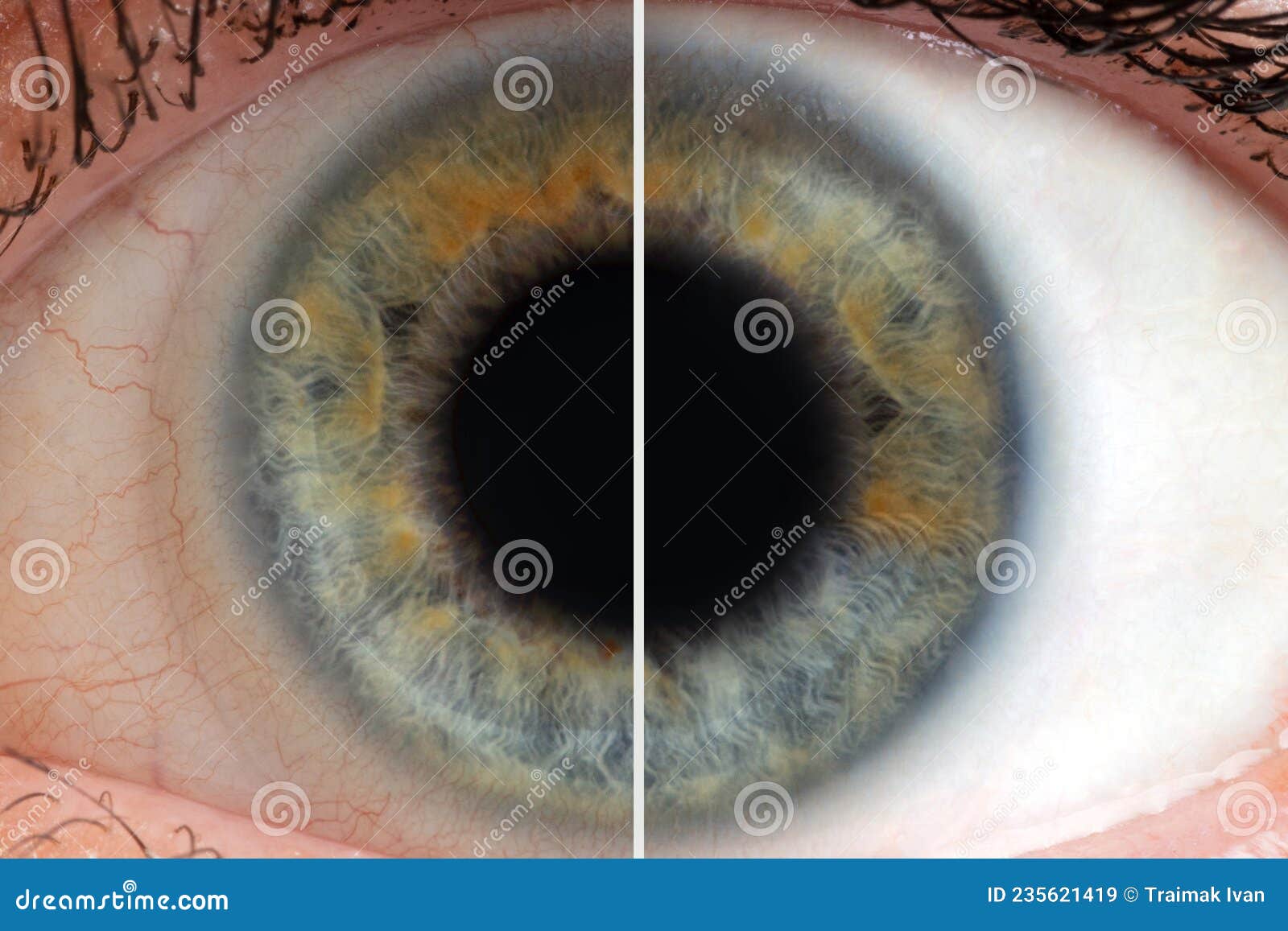 Human Eye with Blood Vessels before and after Stock Image - Image of ...