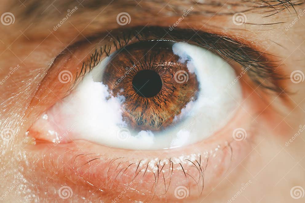 Human Eye with Clouds - Cloudy Vision Concept. Stock Photo - Image of ...