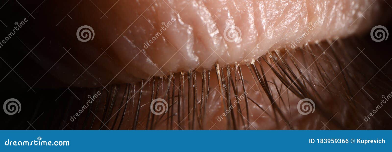Lice In Eyelashes