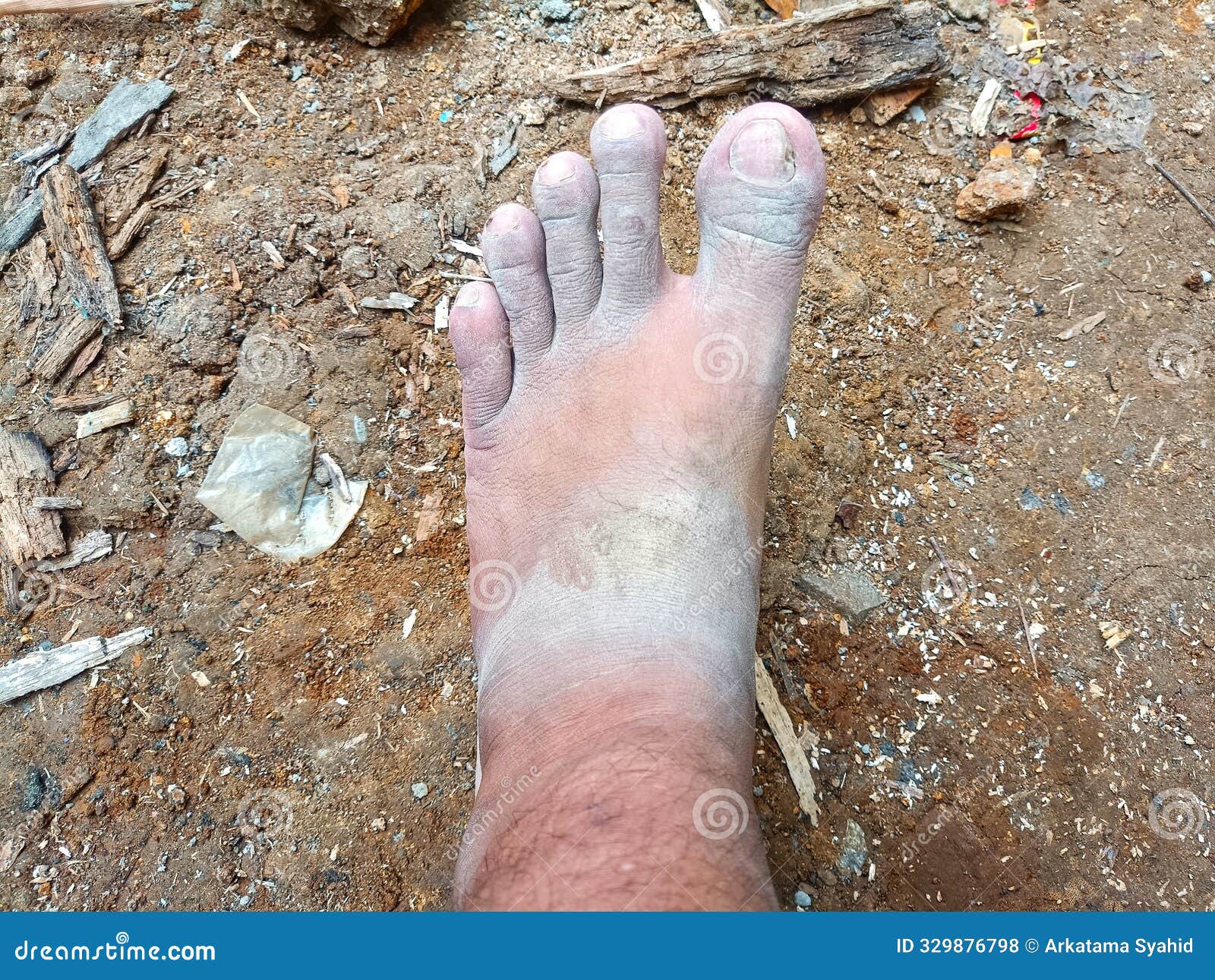 Human Feet are Dirty and Full of Dust Stock Photo - Image of fungus ...