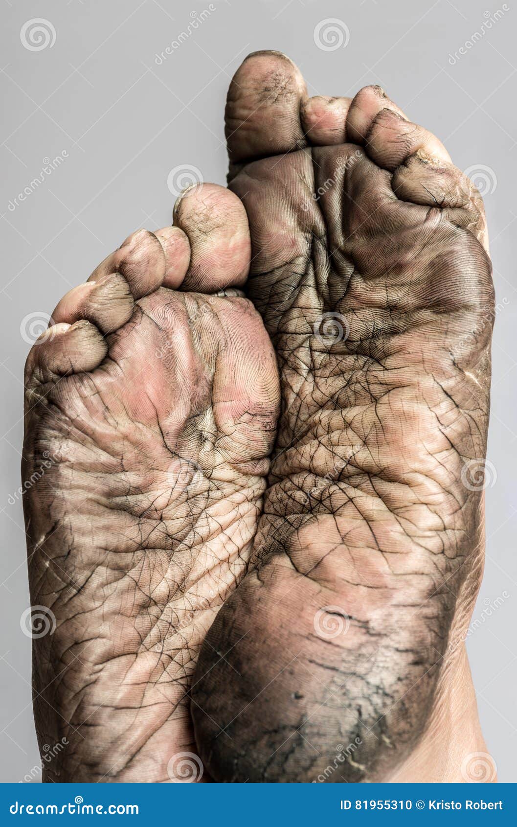 One Foot The Skin Detaches Due To Eczema Royalty-Free Stock Photo ...